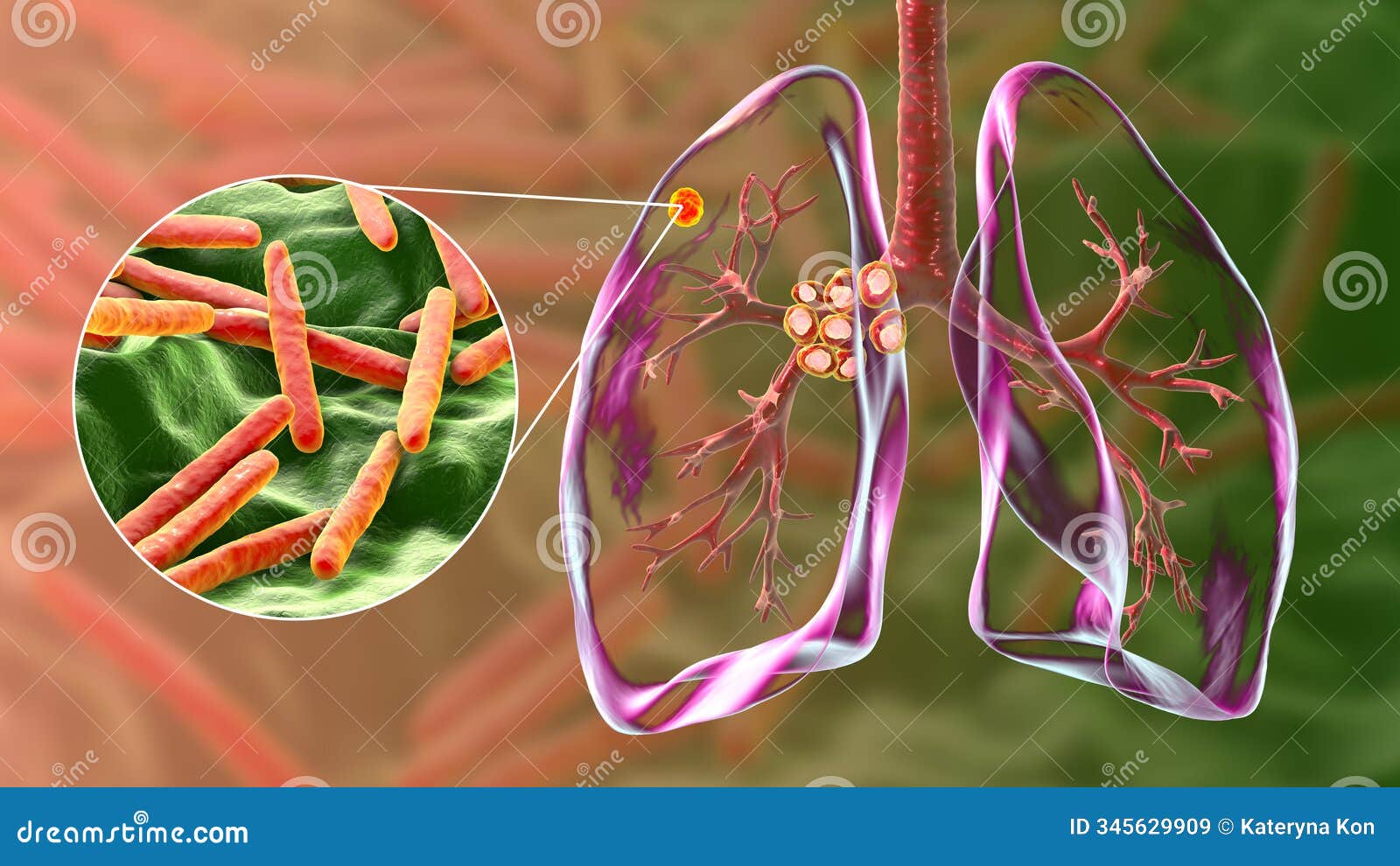 Primary Lung Tuberculosis with the Ranke Complex, 3D Illustration Stock ...
