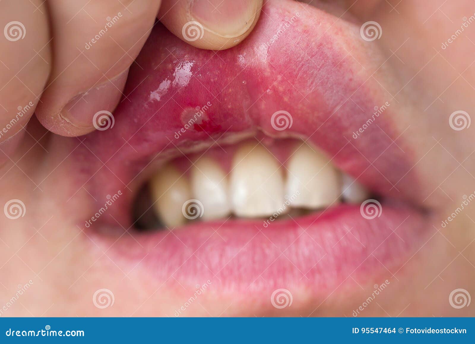 Primer De La Estomatitis En Boca Foto de archivo - Imagen de adulto ...