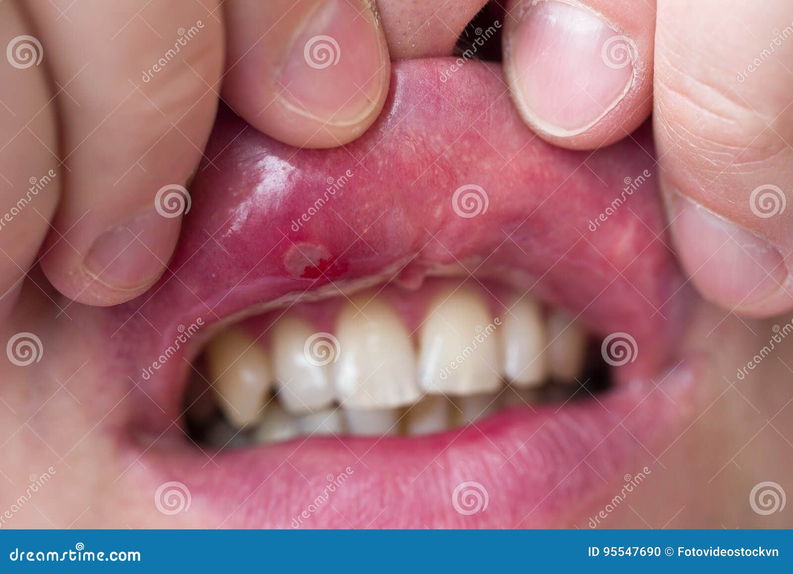 Primer De La Estomatitis En Boca Foto de archivo - Imagen de punto ...