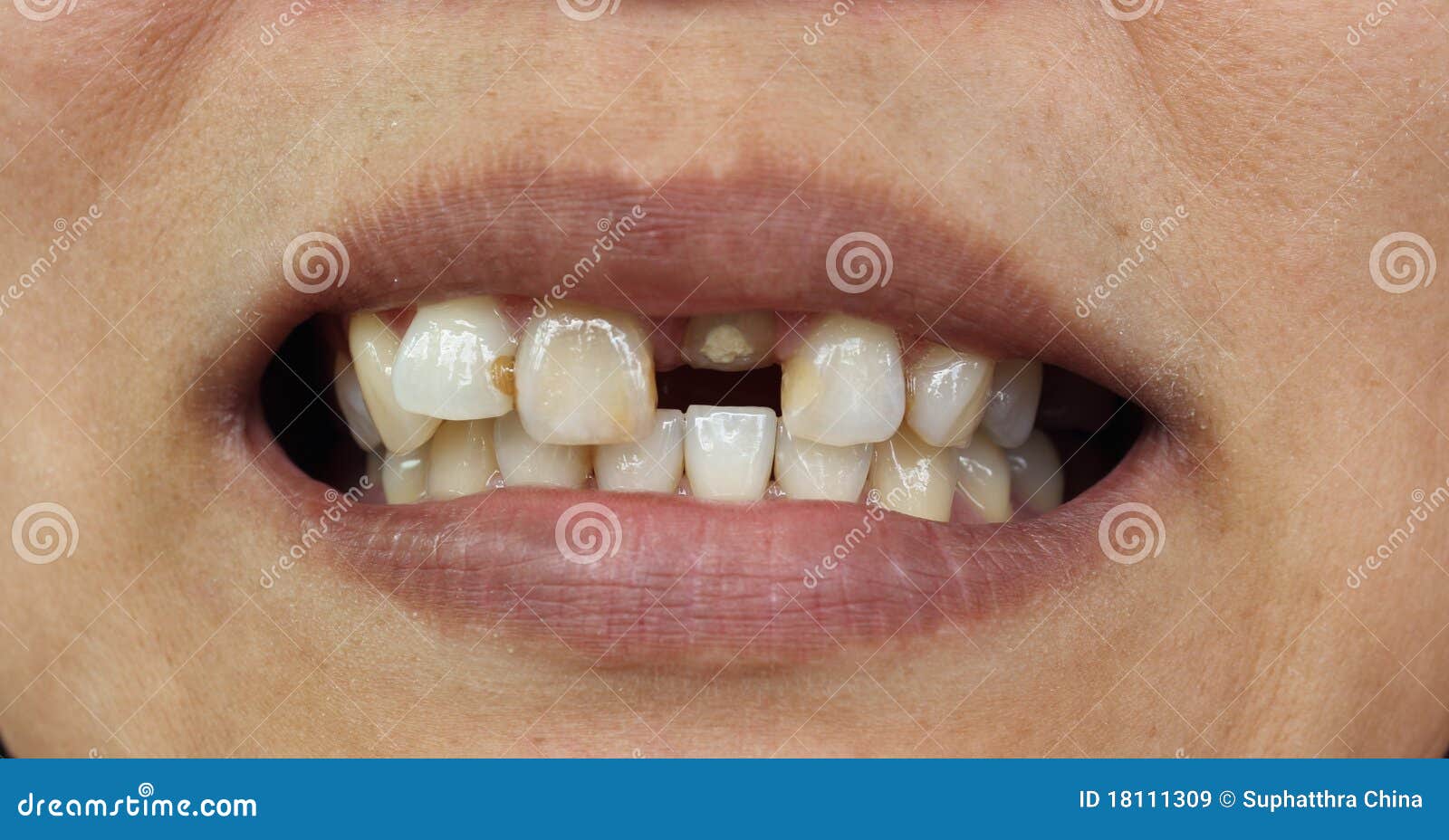 Primer de malos dientes imagen de archivo. Imagen de cierre - 18111309