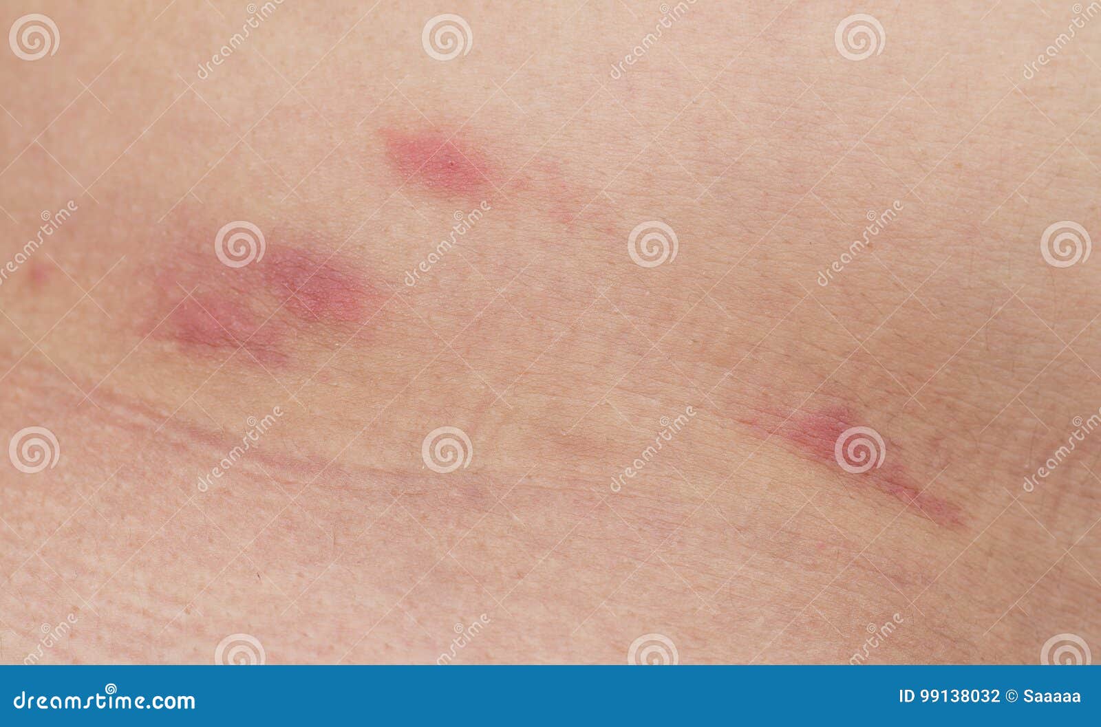 Primo Piano Dei Morsi Di Pulce Fotografia Stock - Immagine di vari ...