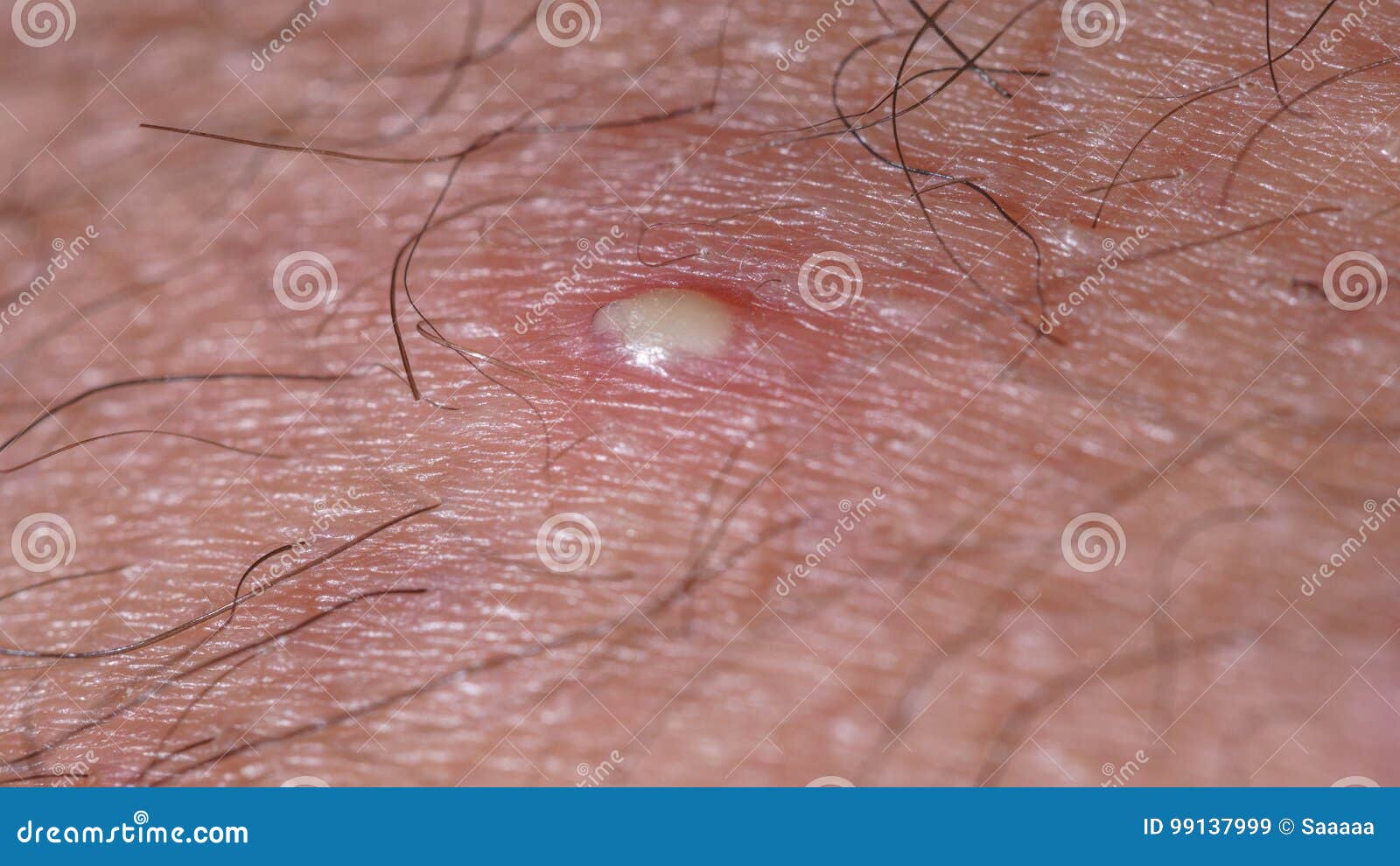 Primo Piano Del Pelo Incarnito Immagine Stock - Immagine di grumo ...