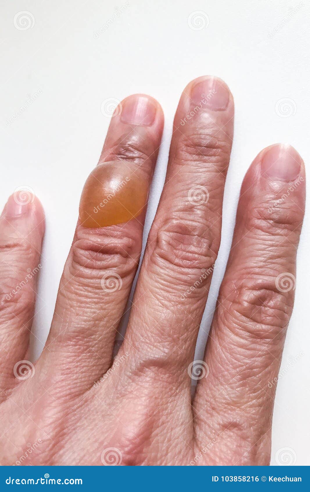 Primo Piano Sul Dito Con Della La Bolla Ripiena Di Fluida Inflammed ... Primo Piano Sul Dito Con Della La Bolla Ripiena Di Fluida Inflammed ...