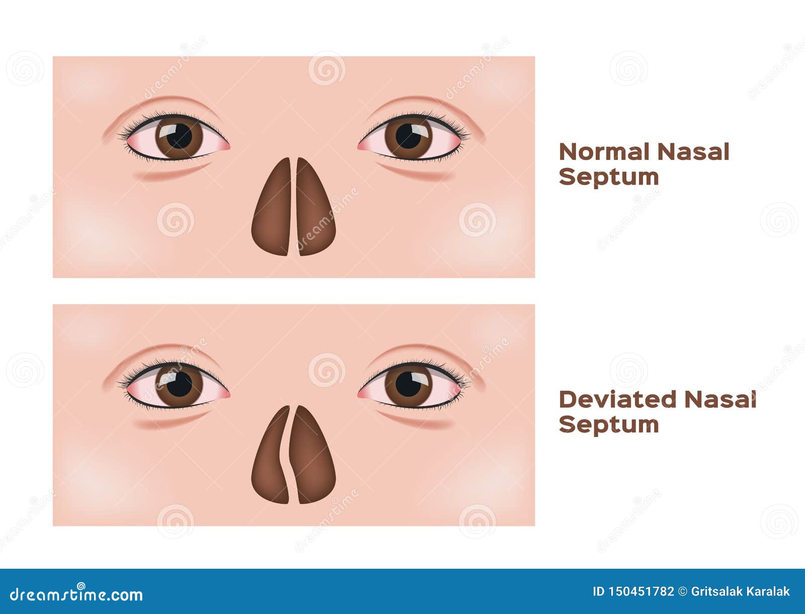 Nasal Septum Deviation Vector Illustration | CartoonDealer.com #200800842
