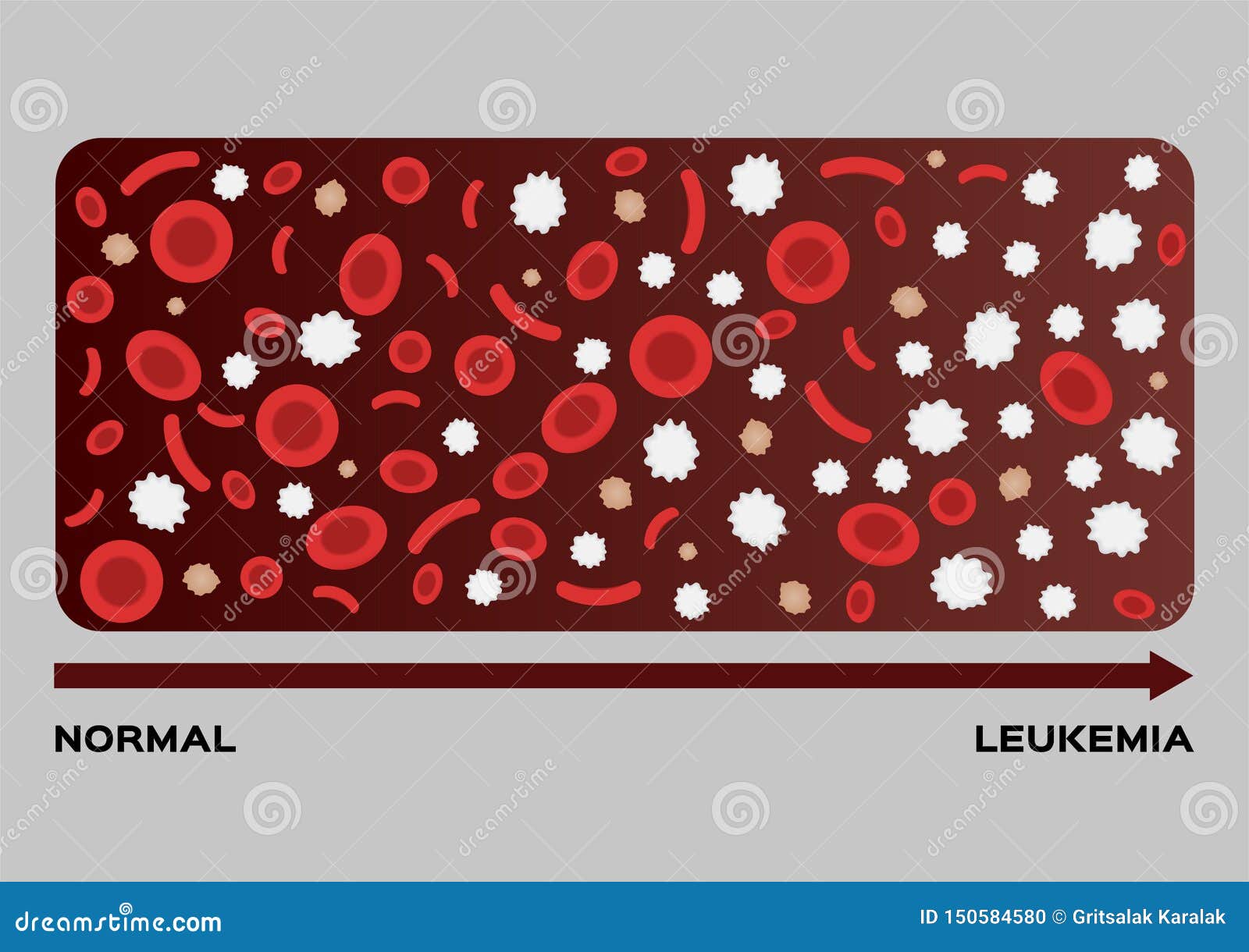 Leukaemia Cartoons, Illustrations & Vector Stock Images - 903 Pictures ...