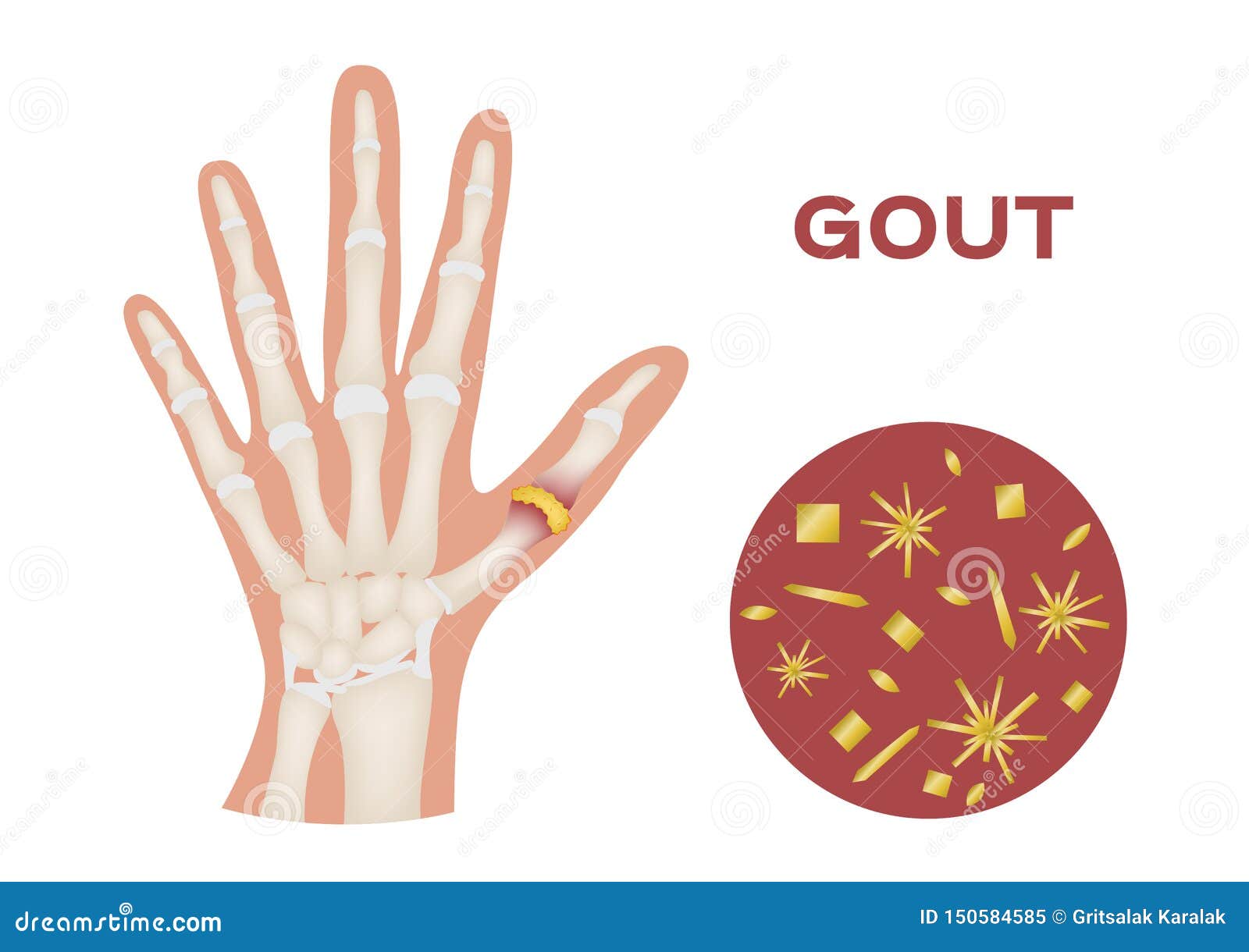 Gout Vector Illustration. Swollen And Inflamed Joint Labeled Scheme ...