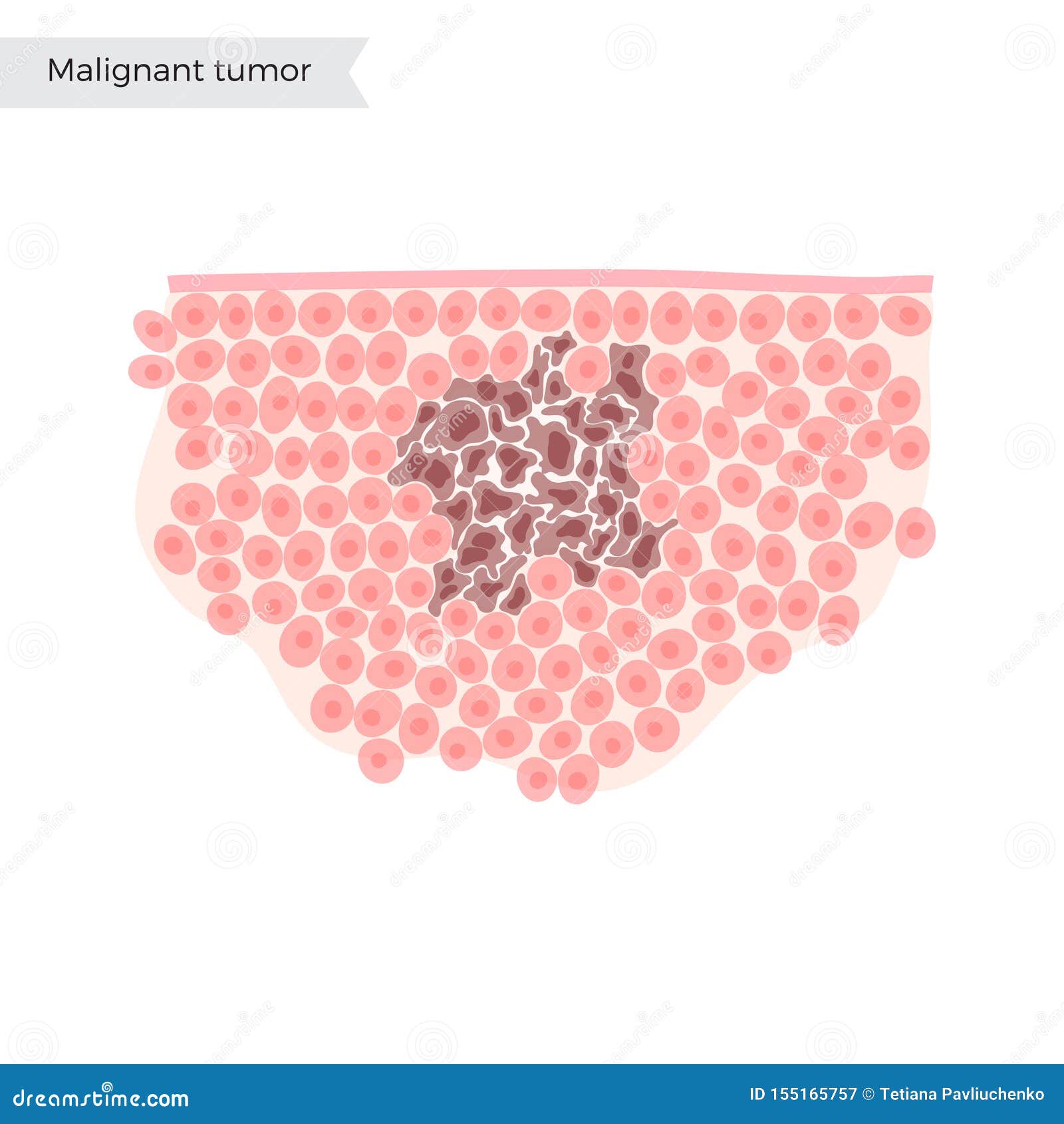 Vector Isolated Illustration of Malignant Tumor Stock Vector ...