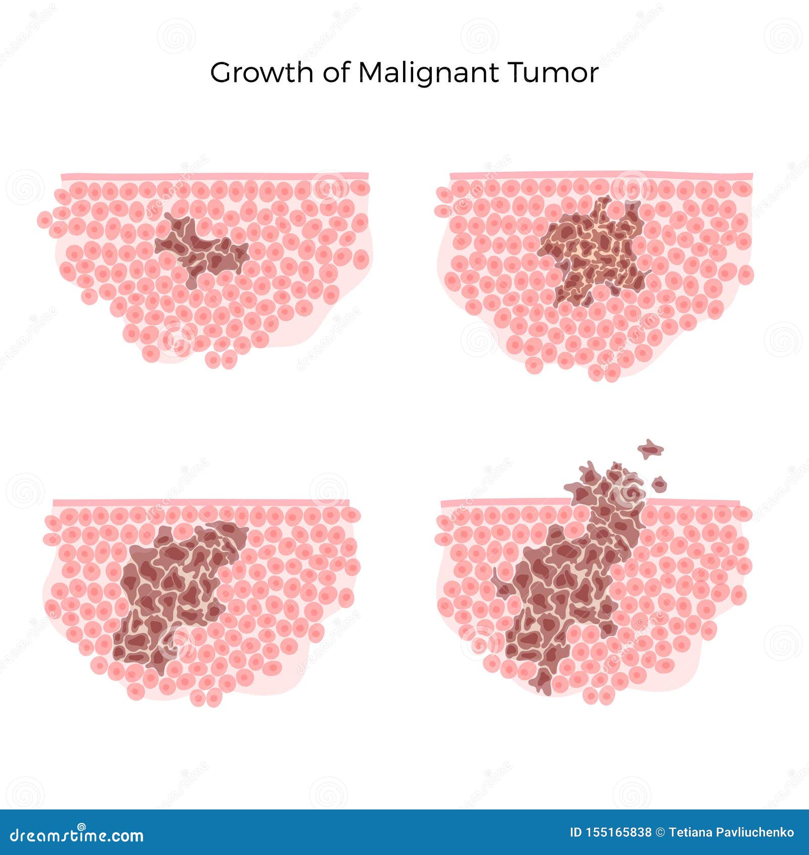 Vector Isolated Illustration of Malignant Tumor Stock Vector ...