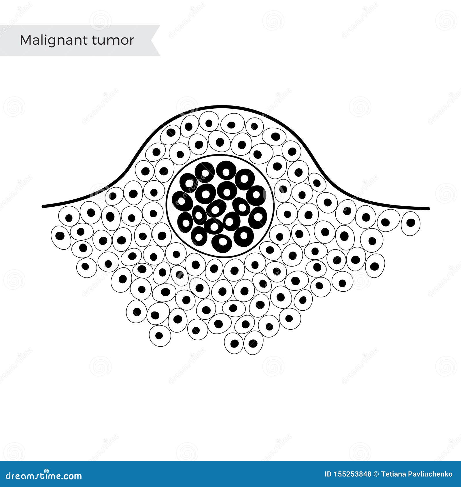 Vector Isolated Illustration of Benign Tumor Stock Vector ...
