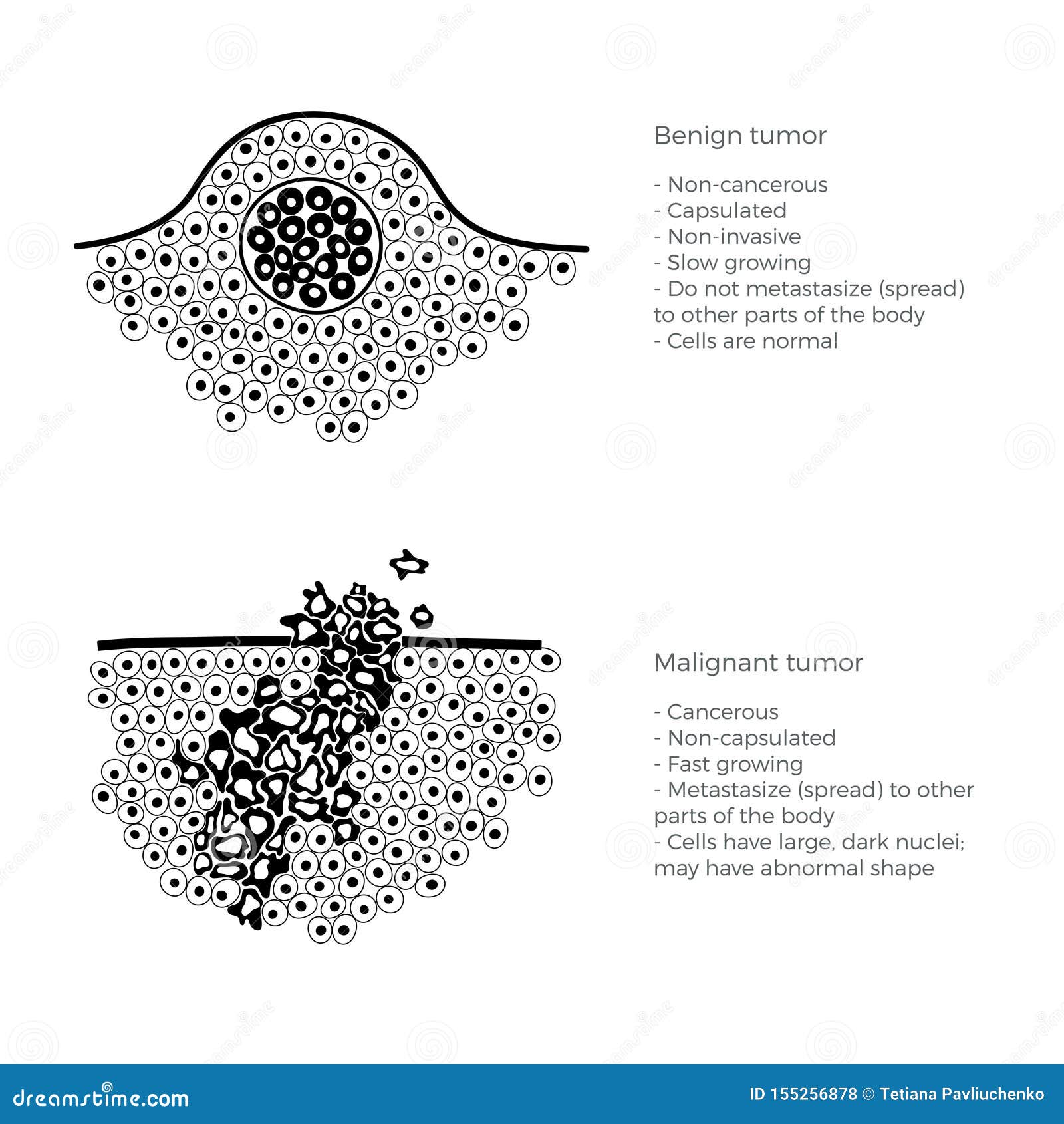 Vector Illustration of Malignant and Benign Tumor Stock Vector ...