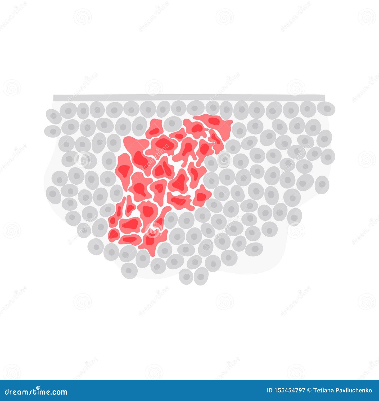 Vector Isolated Illustration of Malignant Tumor Stock Vector ...