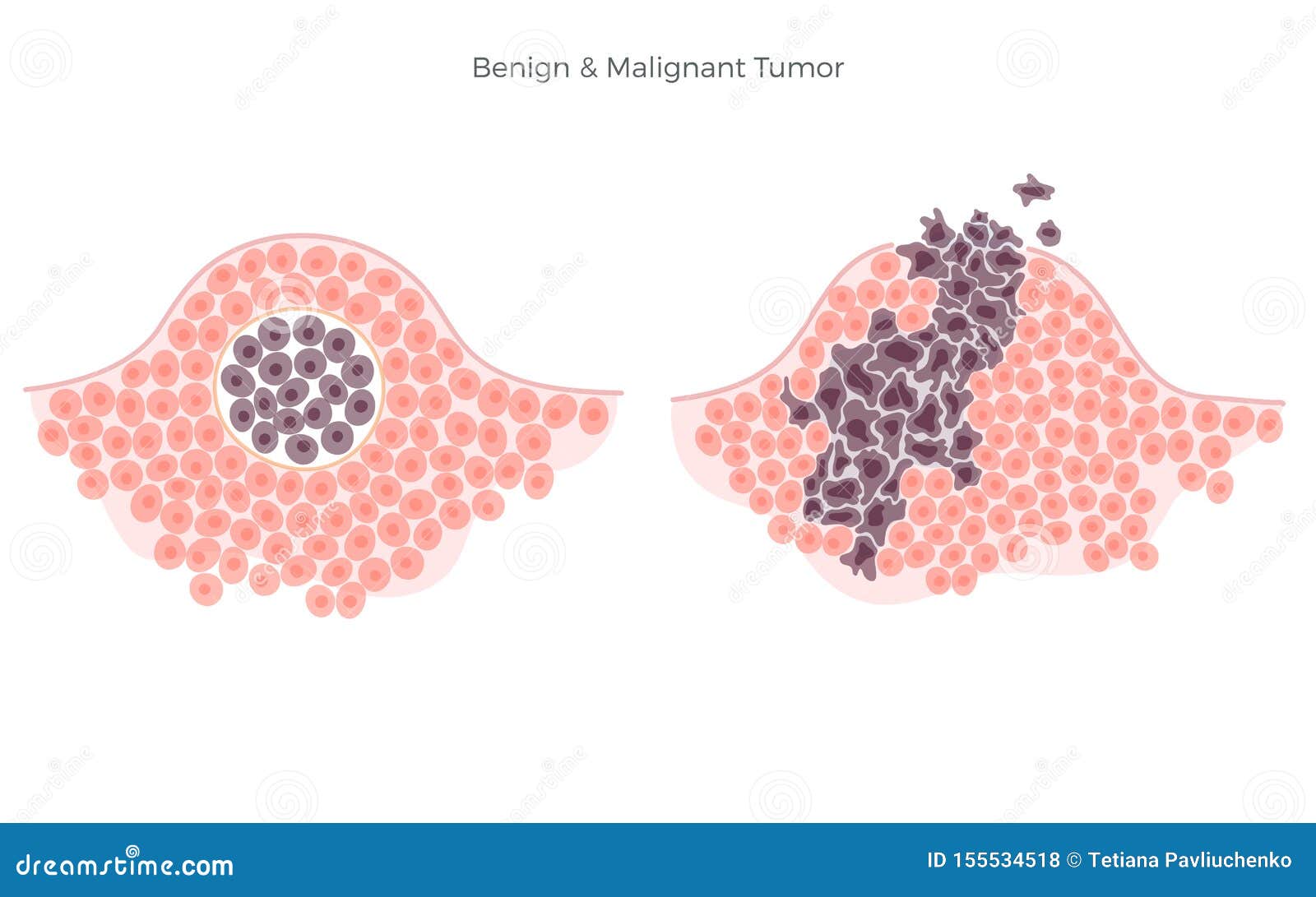 Vector Illustration of Malignant and Benign Tumor Stock Vector ...