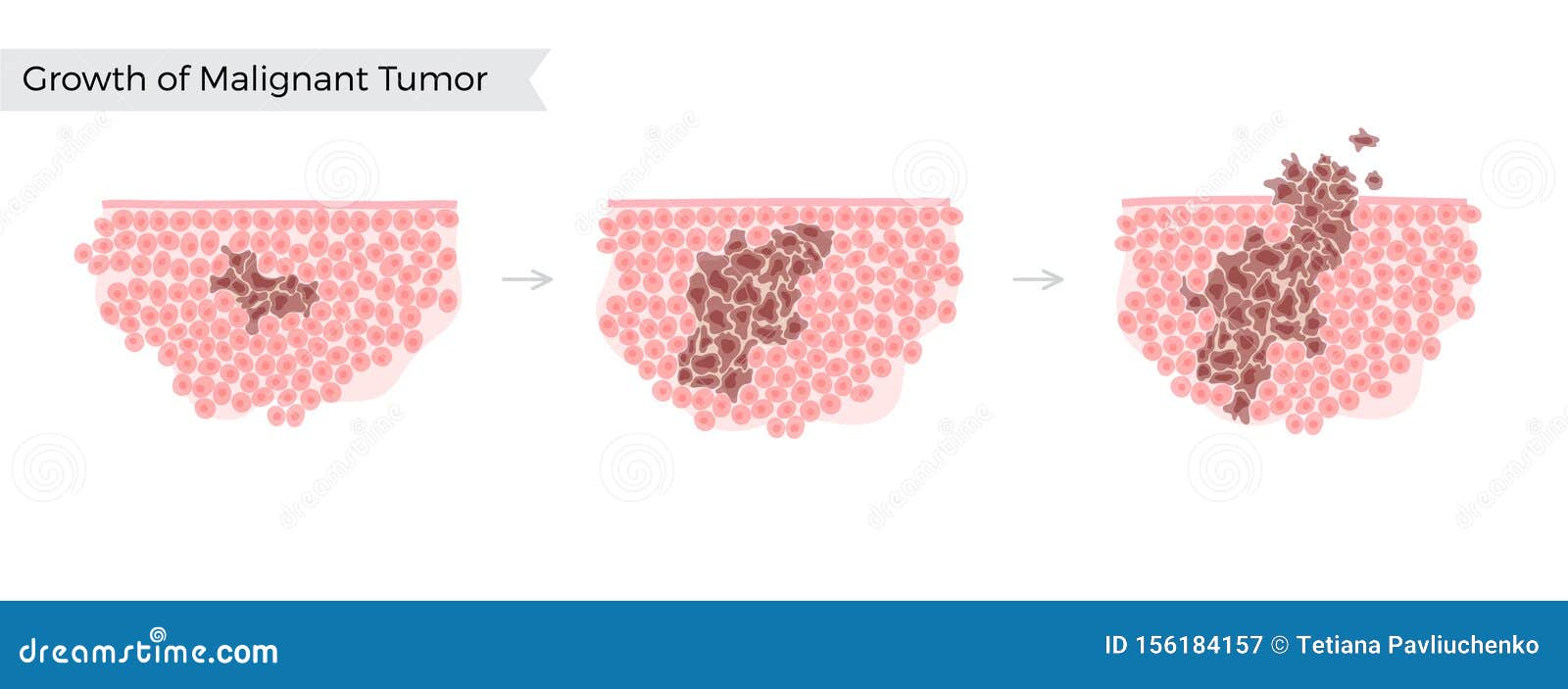 Vector Isolated Illustration of Malignant Tumor Stock Vector ...