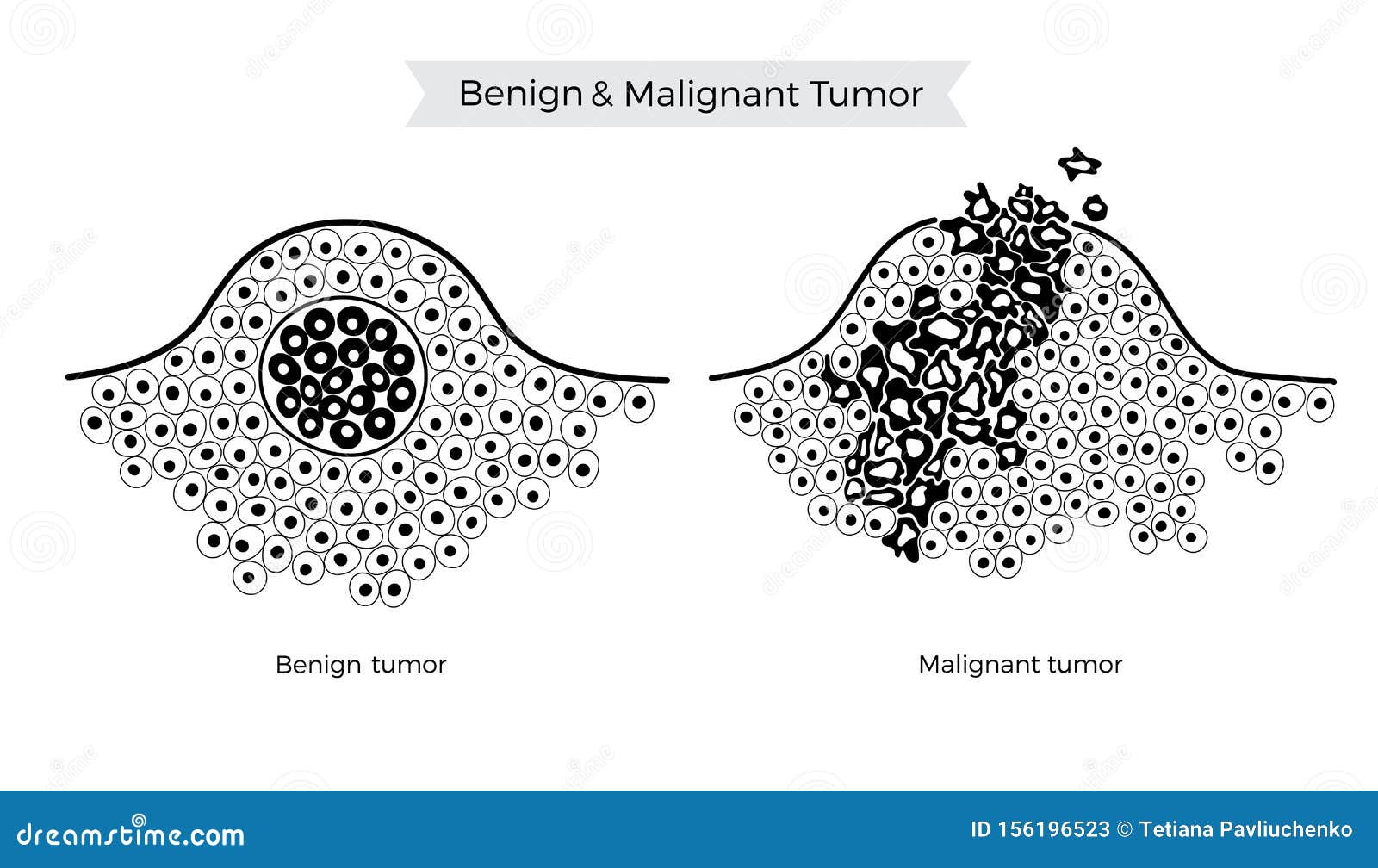 Vector Illustration of Malignant and Benign Tumor Stock Vector ...
