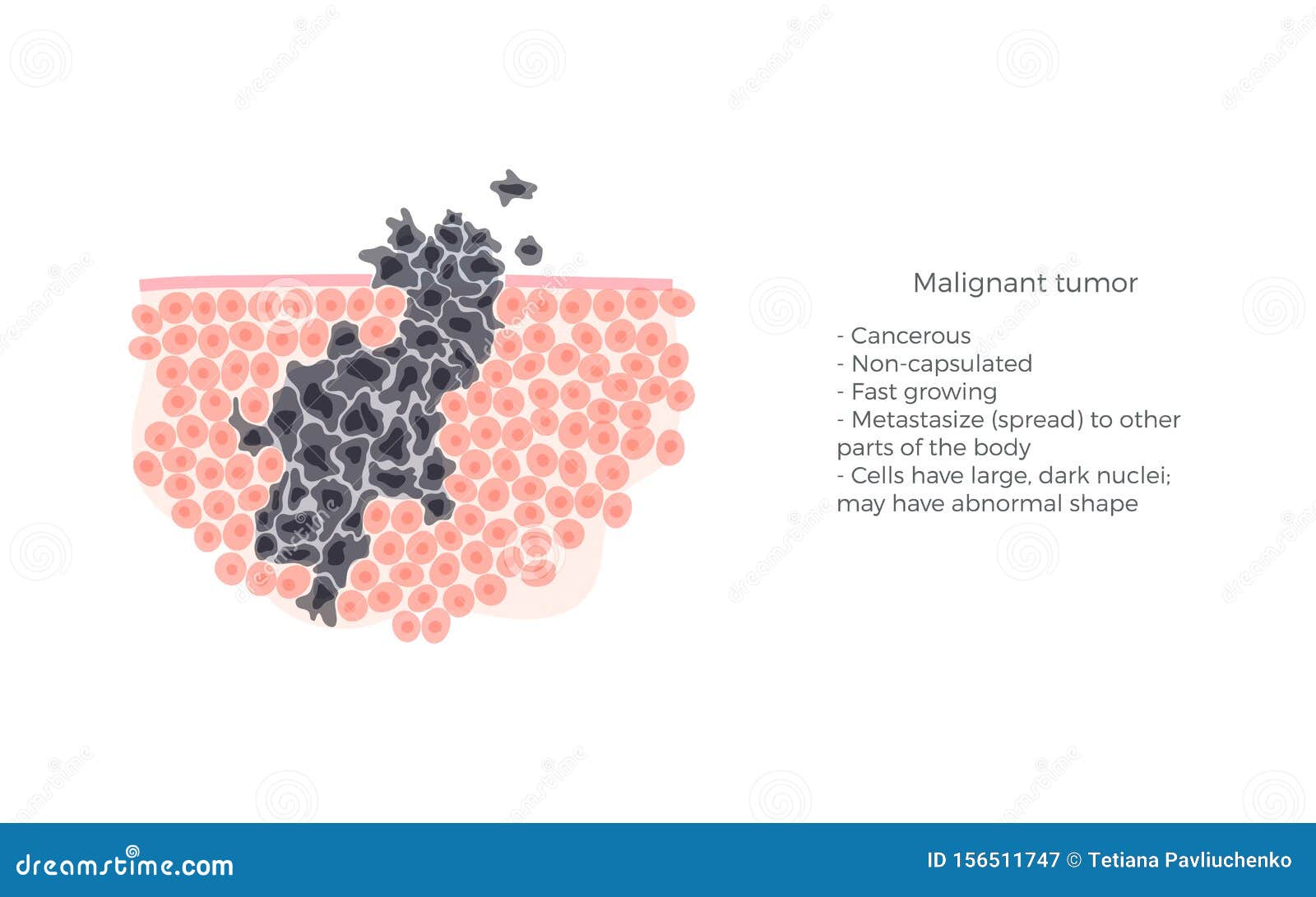 Vector Isolated Illustration of Malignant Tumor Stock Vector ...