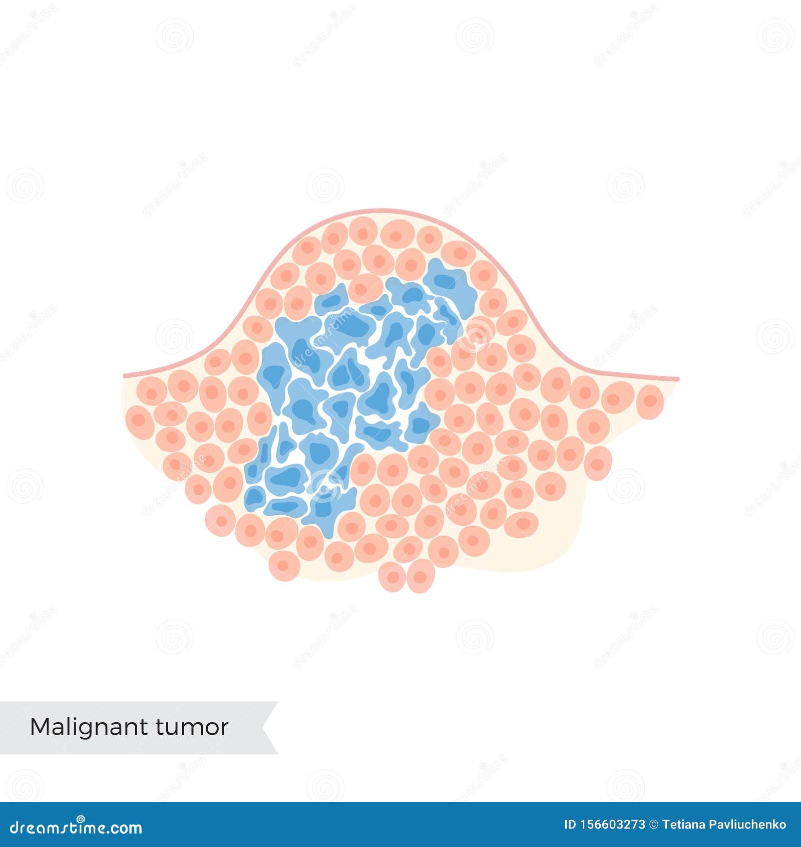 Vector Isolated Illustration of Malignant Tumor Stock Vector ...