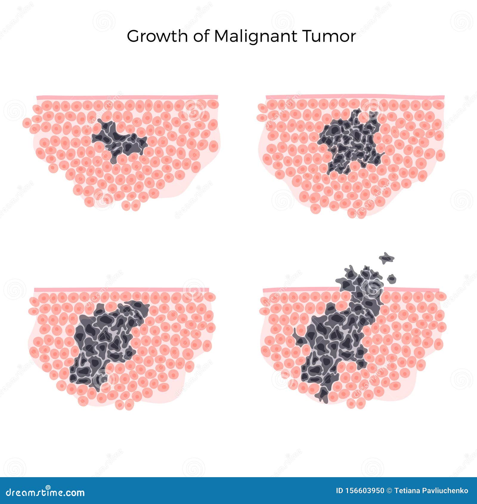 Vector Isolated Illustration of Malignant Tumor Stock Vector ...