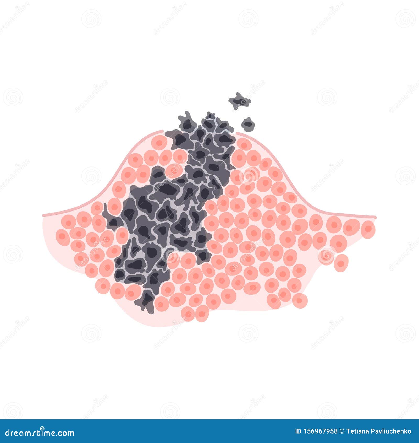 Vector Isolated Illustration of Malignant Tumor Stock Vector ...