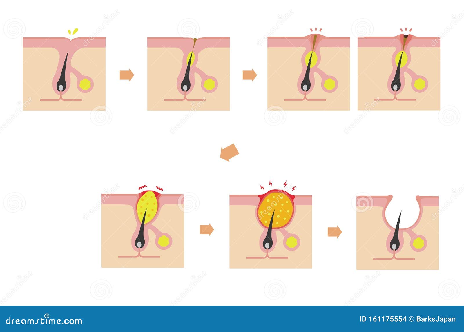 Acne Types Infographic Elements Vector Flat Illustration Girl With