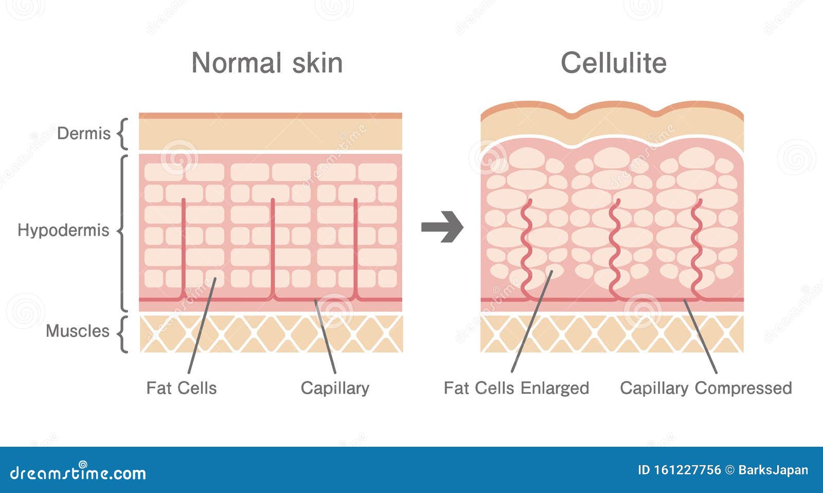 Skin With Cellulite Cross-section Of Human Skin Layers Structure ...