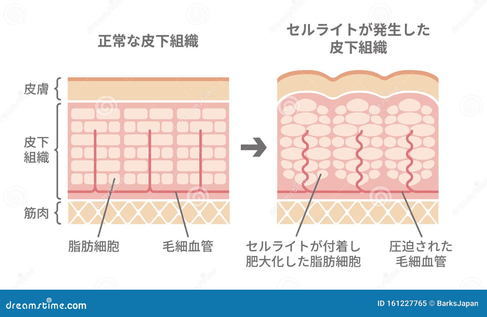 Skin With Cellulite Cross-section Of Human Skin Layers Structure ...