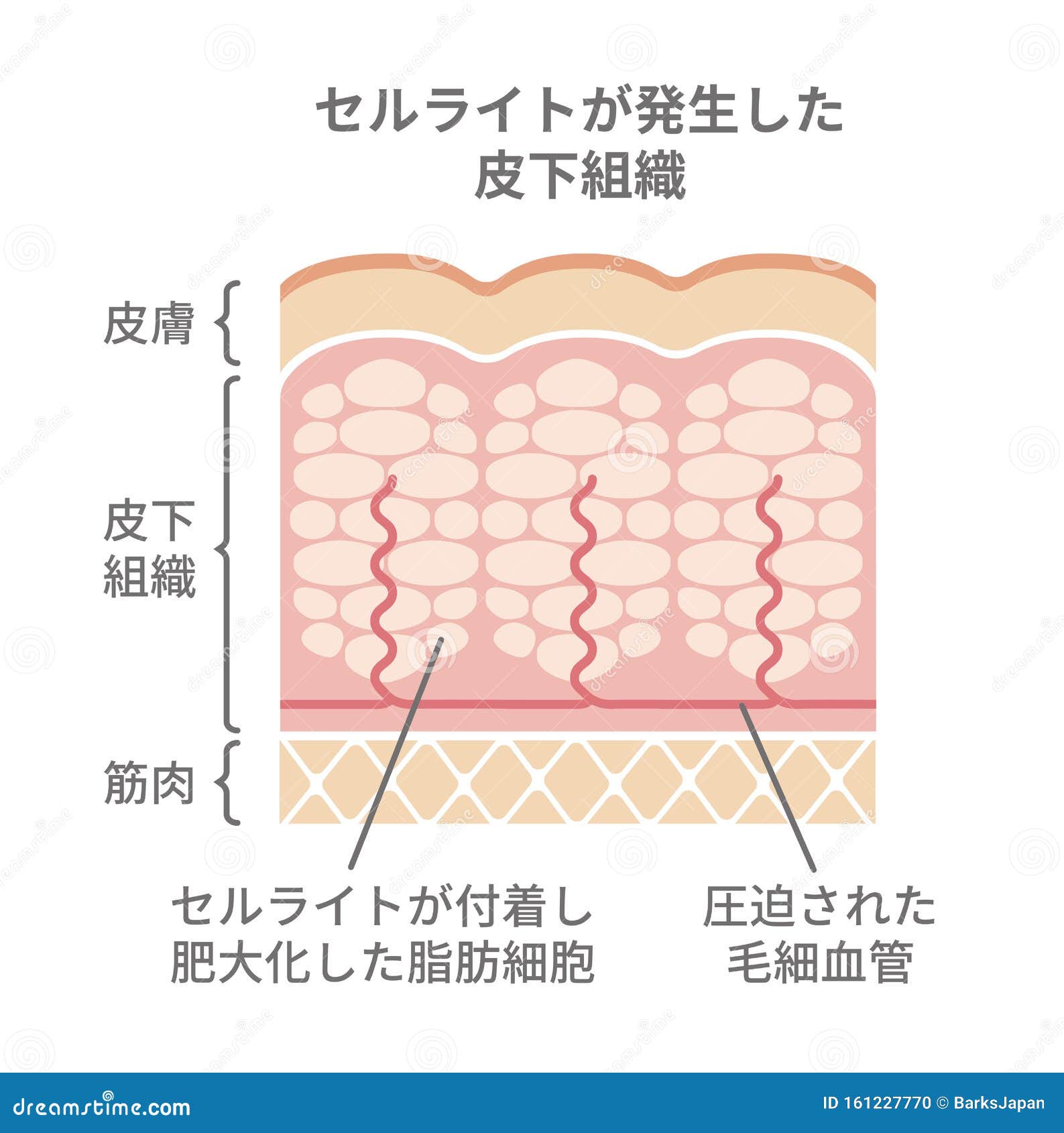 Cellulite`s Skin Vector Illustration Stock Vector - Illustration of ...