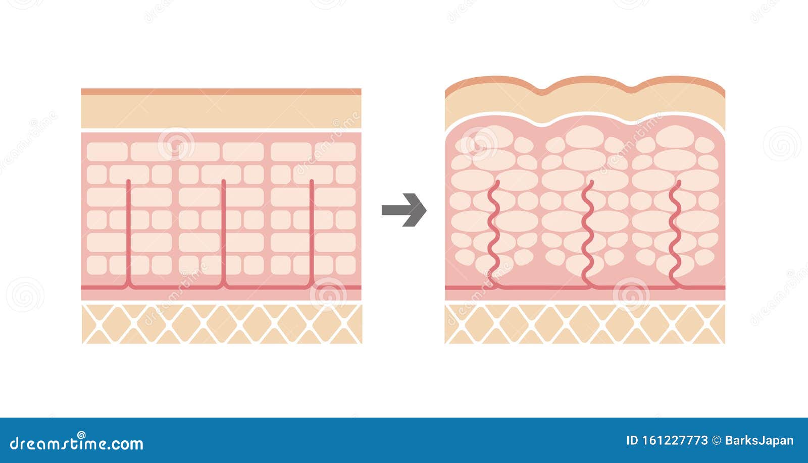 Skin With Cellulite Cross-section Of Human Skin Layers Structure ...