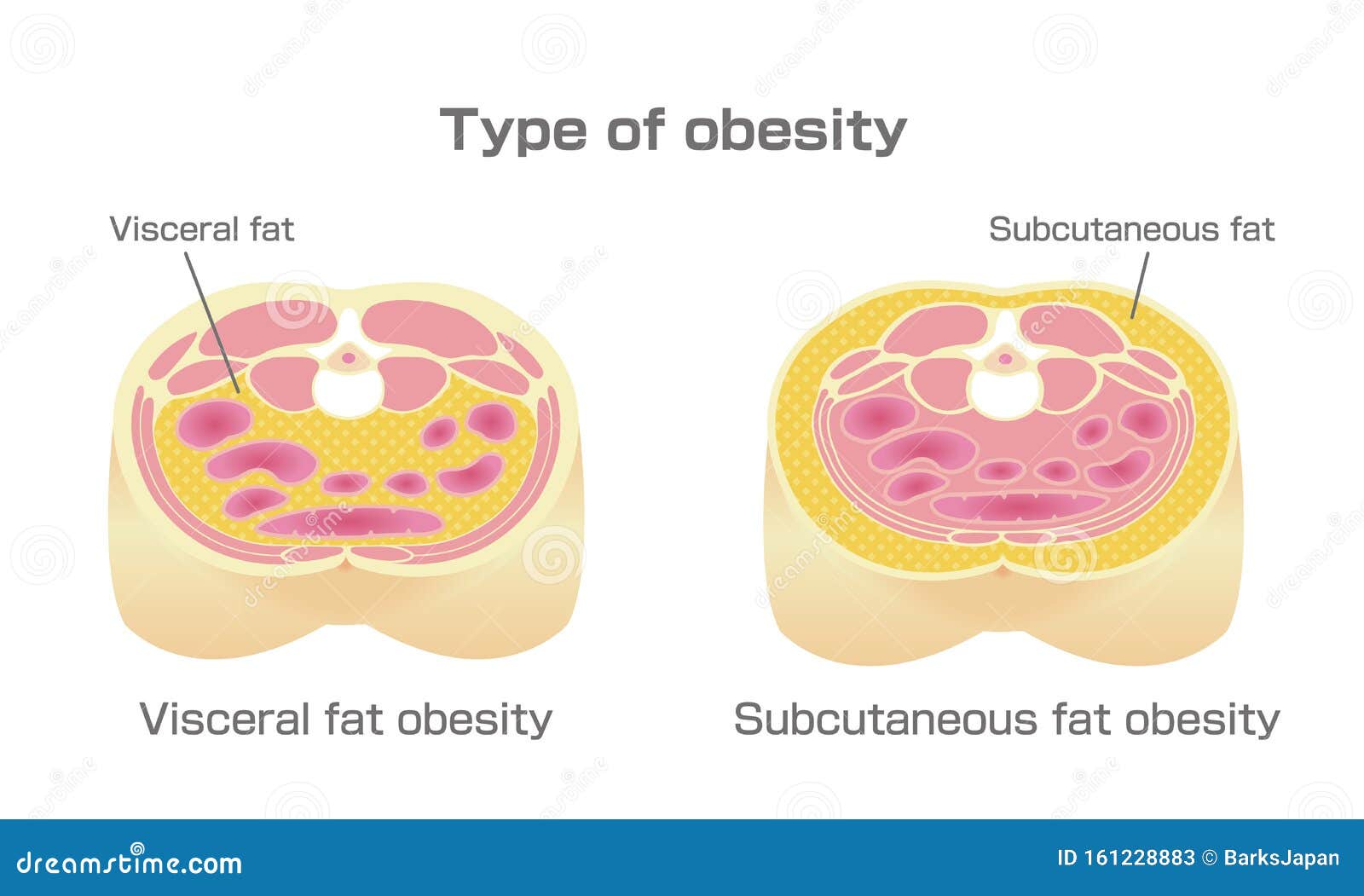 Visceral And Subcutaneous Fat Around Waistline. Location Of Visceral ...