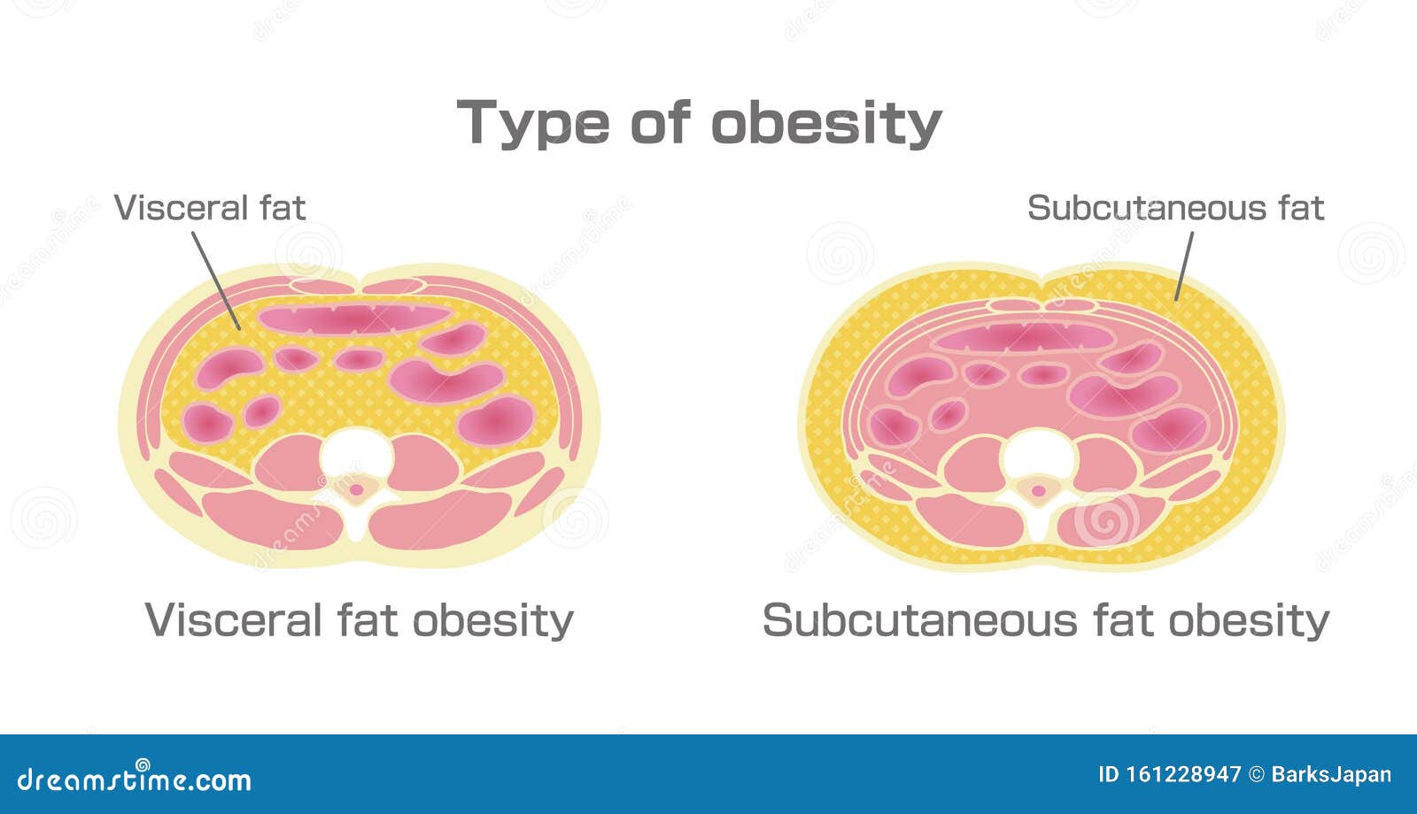 Type of Obesity Illustration / English Stock Vector - Illustration of ...