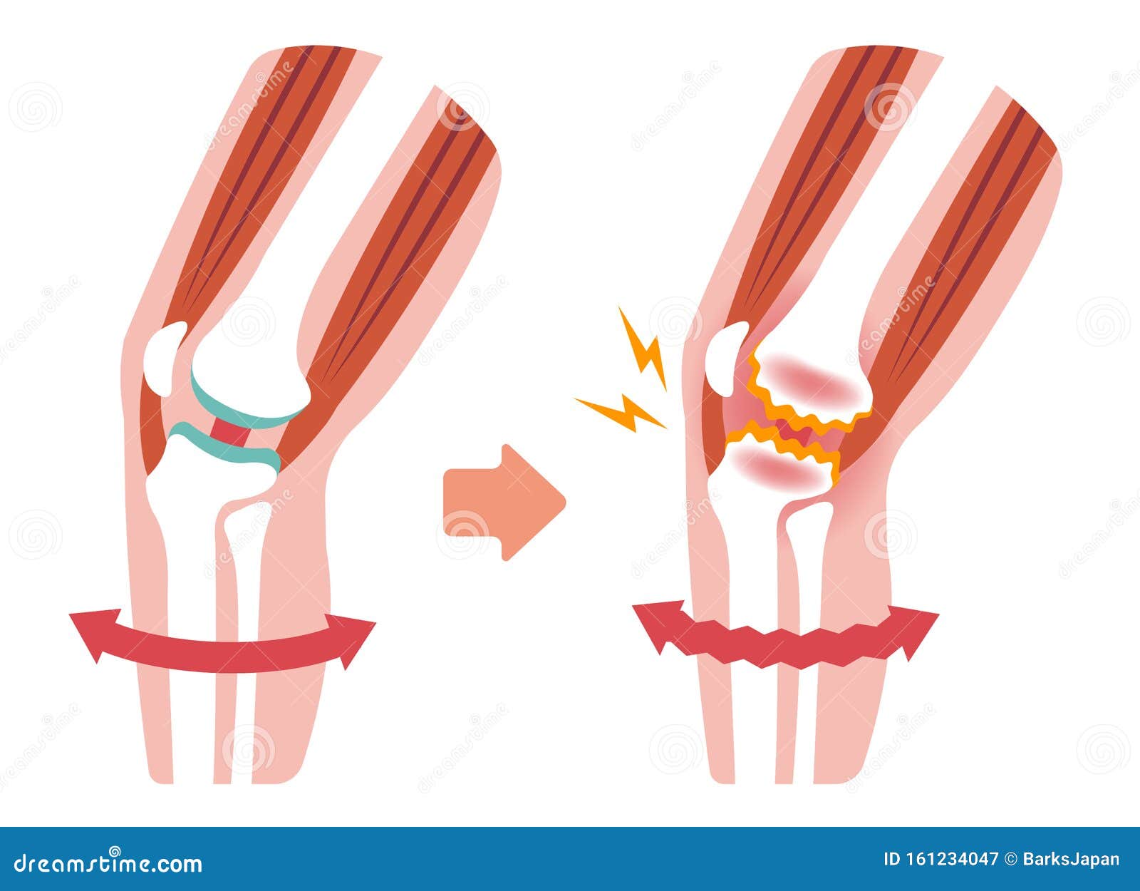 Mechanism Of ACL Injury As Knee Trauma Anatomical Explanation Outline ...