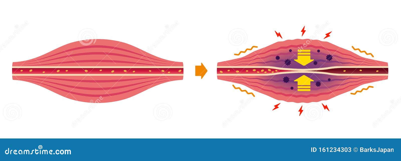 Process of Muscle`s Stiffness and Pain / No Text Stock Vector ...