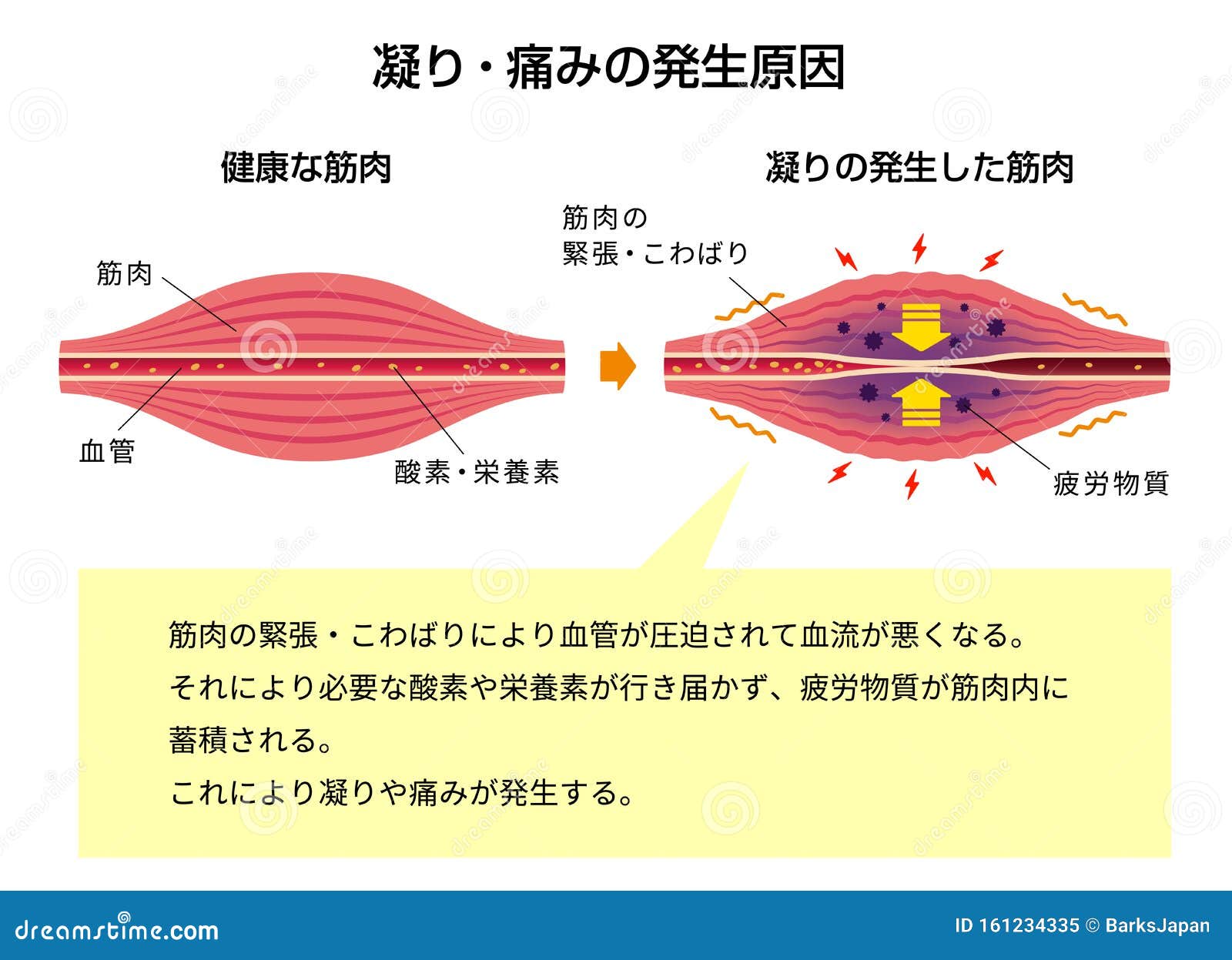 Process Of Muscle`s Stiffness And Pain / English Vector Illustration ...