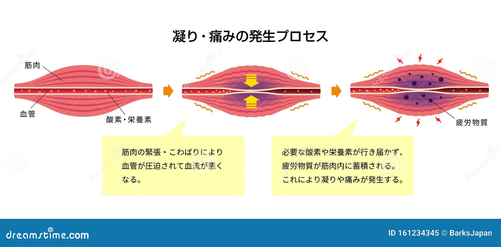 Process Of Muscle`s Stiffness And Pain / English Cartoon Vector ...