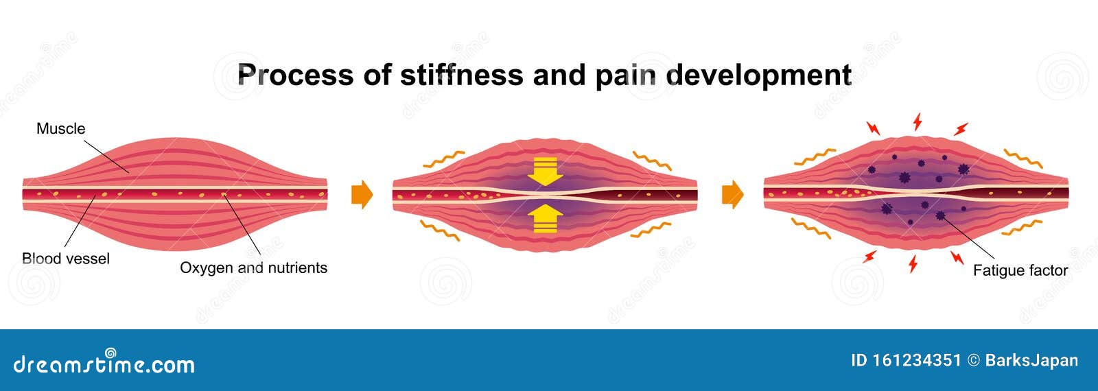 Process Of Muscle`s Stiffness And Pain / English Vector Illustration ...