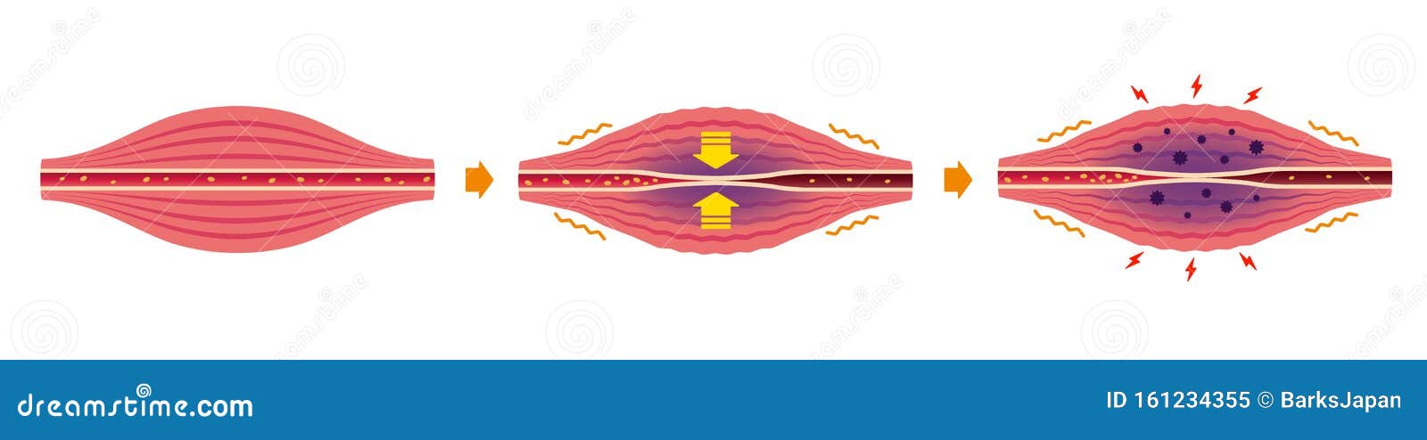 Process Of Muscle`s Stiffness And Pain / English Vector Illustration ...