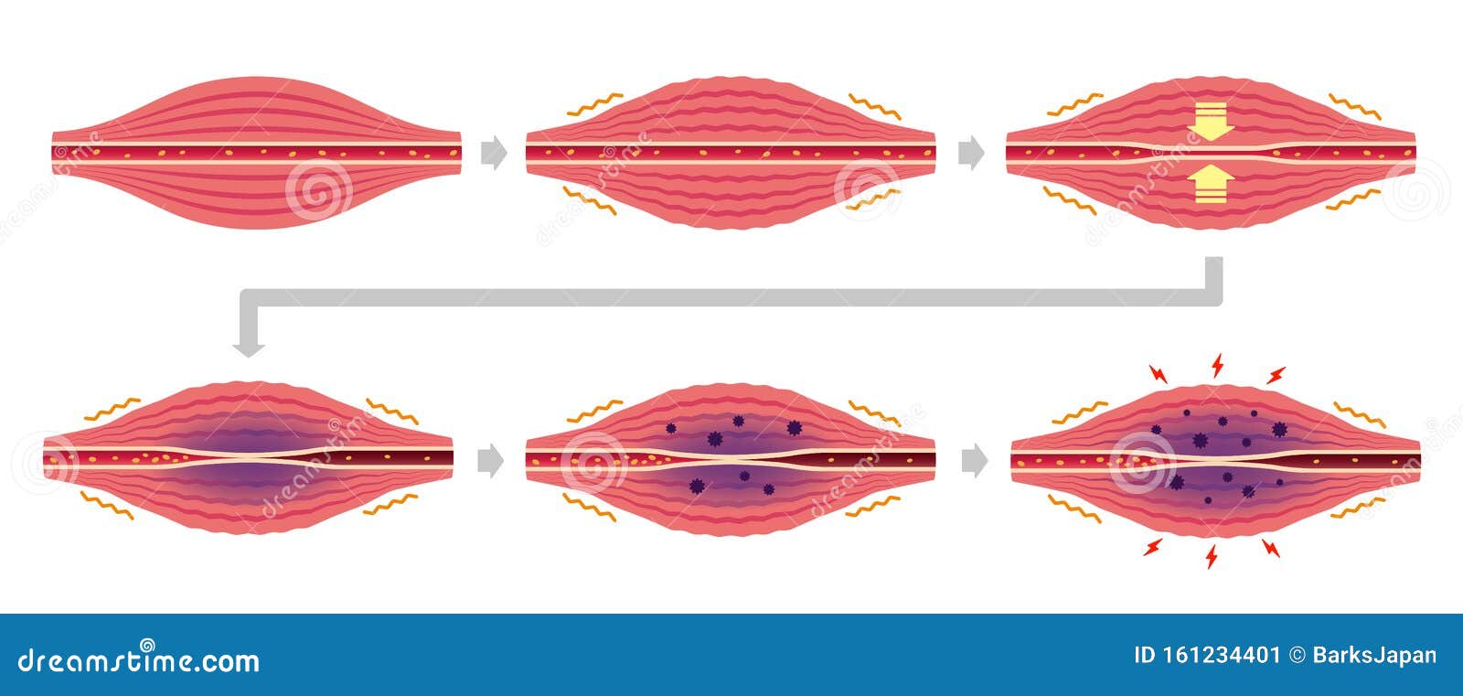 Process of Muscle`s Stiffness and Pain / No Text Stock Vector ...