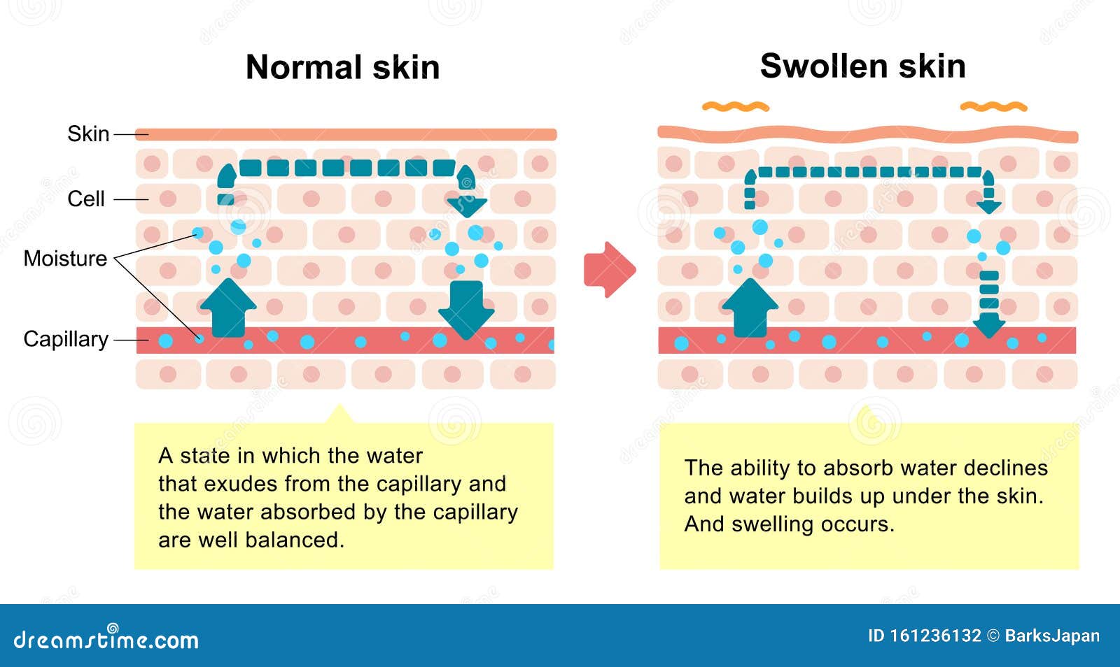 Comparison Illustration of Normal Skin and Swollen Skin / English Stock ...