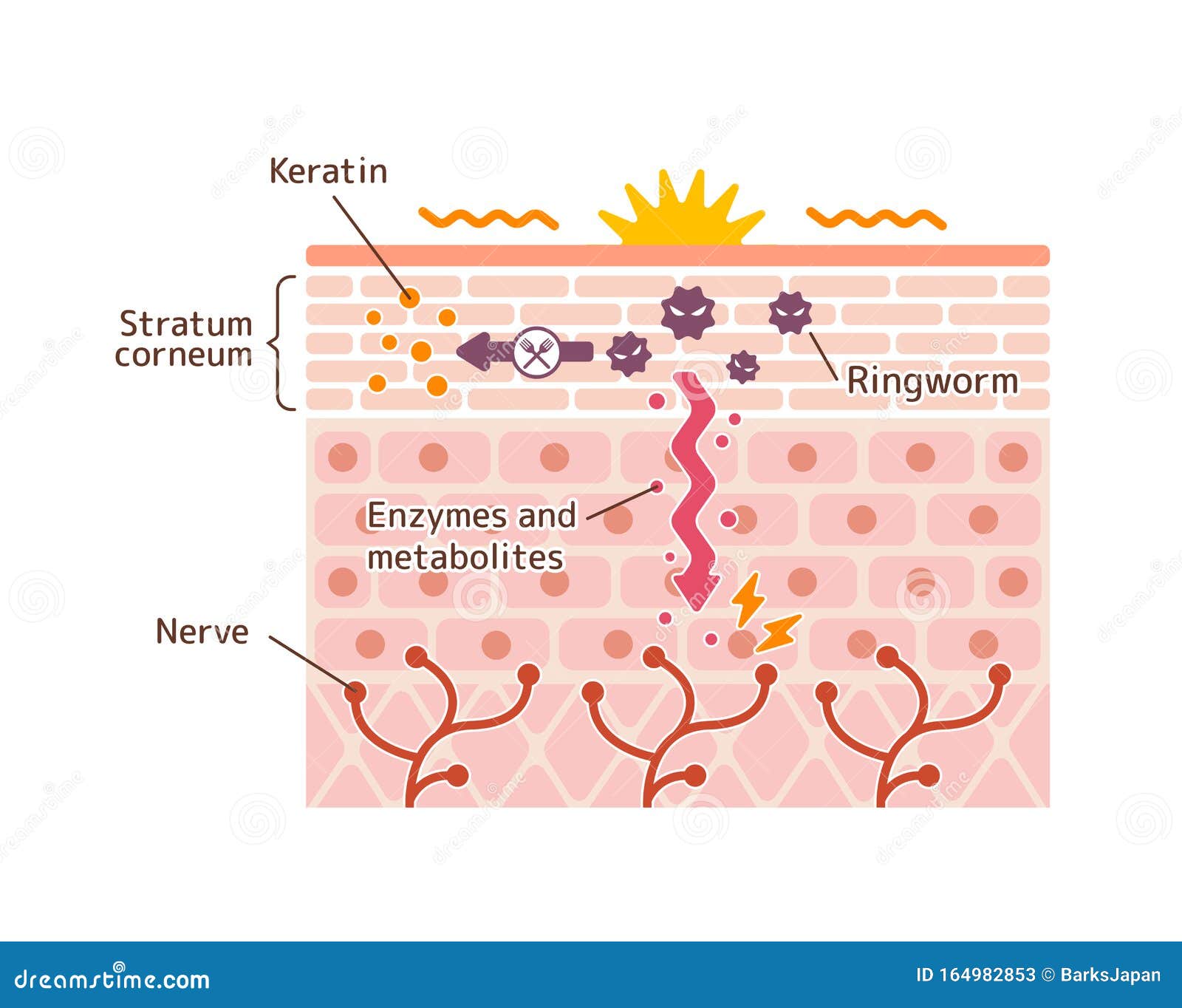 Ringworm Vector Illustration. Labeled Fungal Skin Infection Example ...