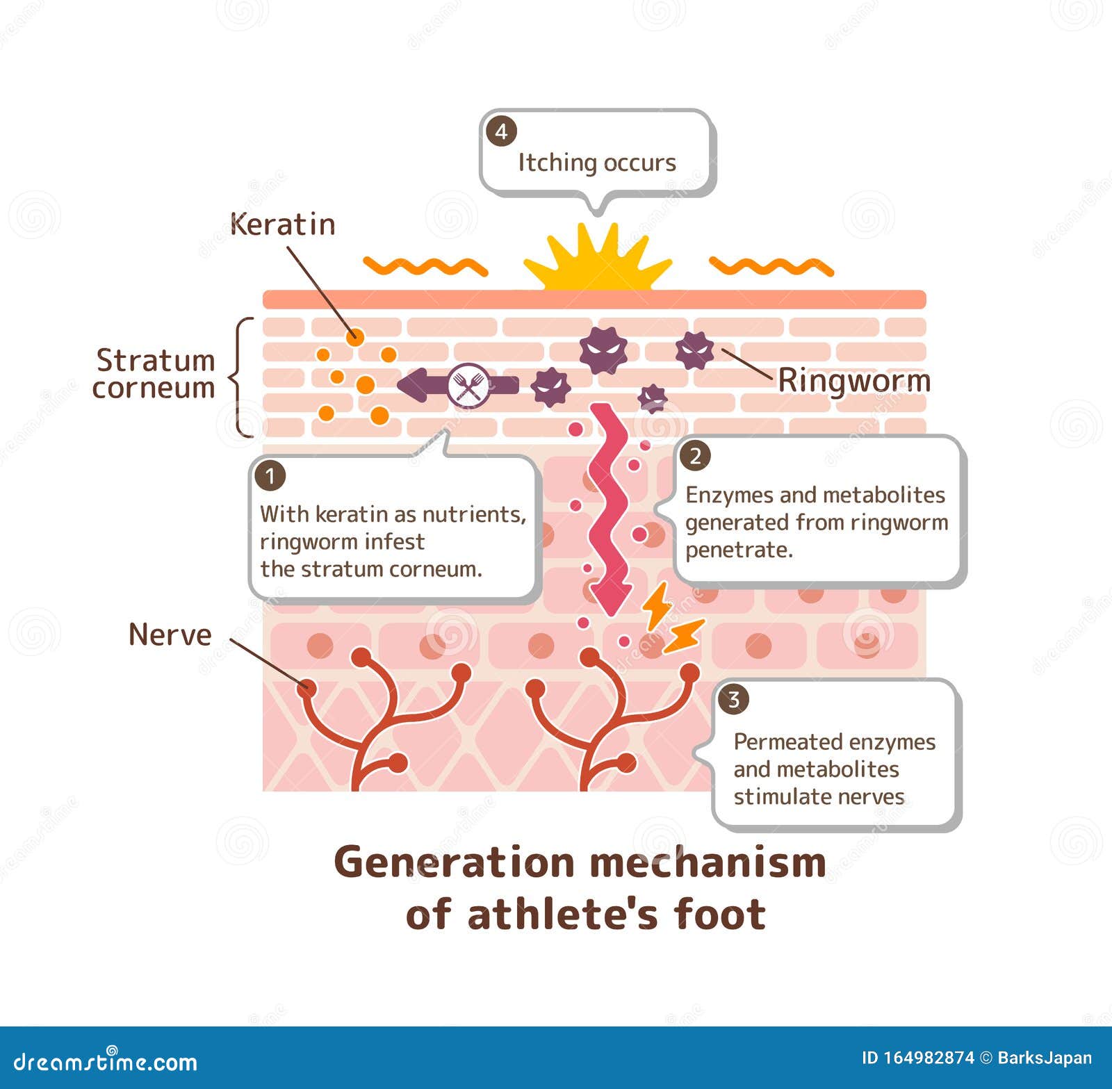 Ringworm Vector Illustration. Labeled Fungal Skin Infection Example ...