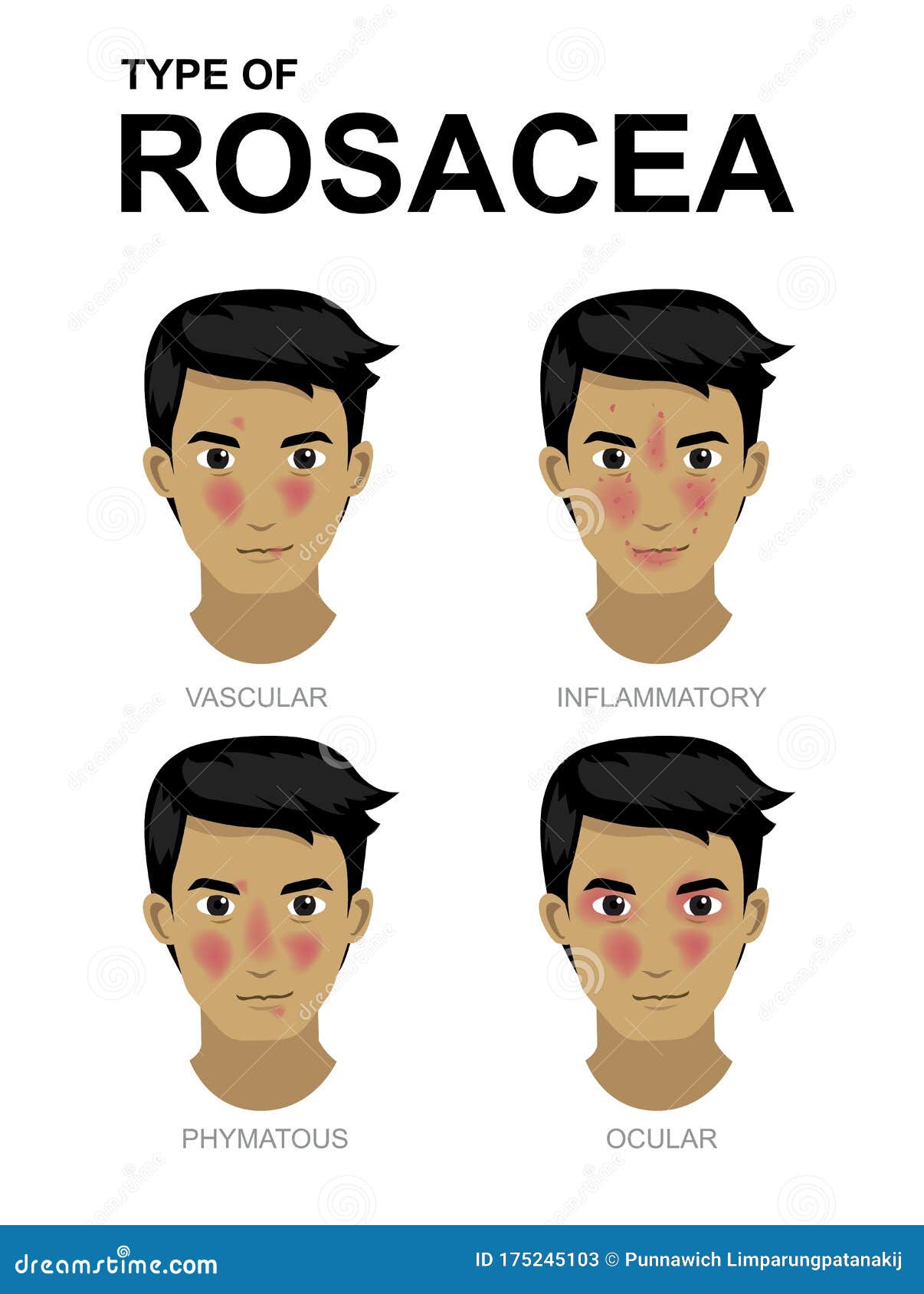 Manga Cartoon Type of Rosacea Man Set Stock Vector - Illustration of ...