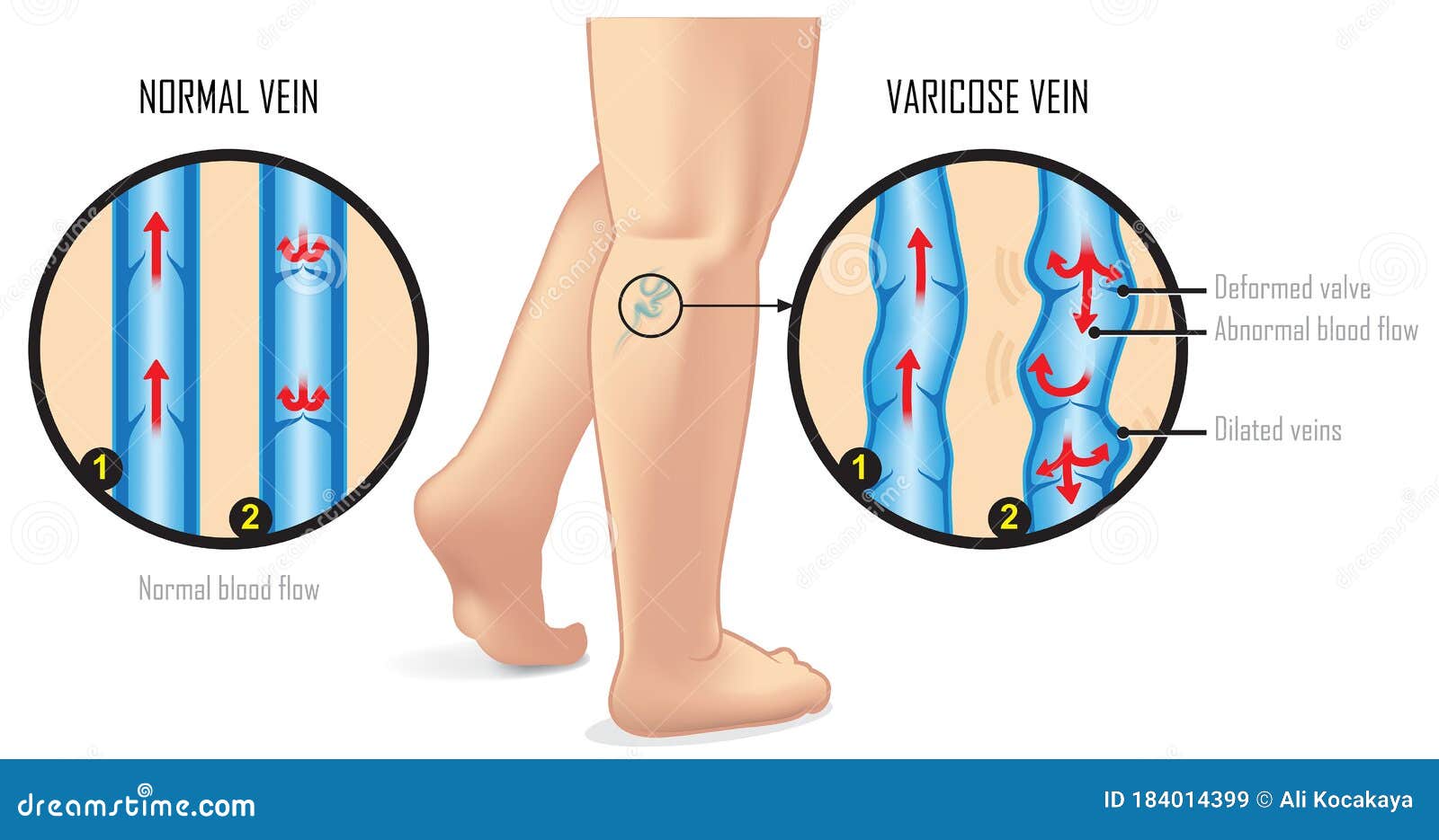 Varicose veins stock vector. Illustration of illustrations - 184014399
