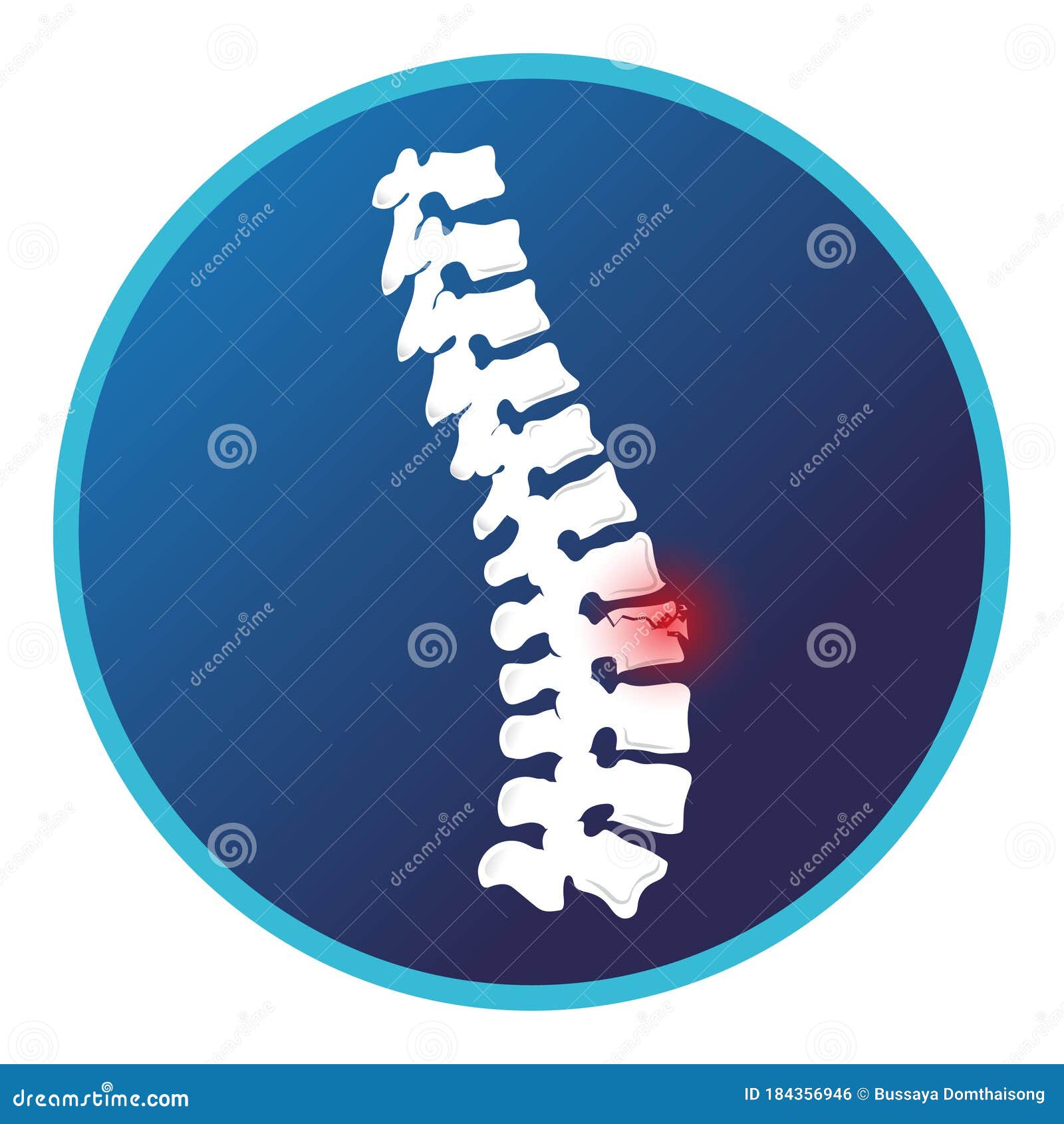 Spine Fracture Royalty-Free Stock Photography | CartoonDealer.com #65613431 Spine Fracture Royalty-Free Stock Photography | CartoonDealer.com #65613431