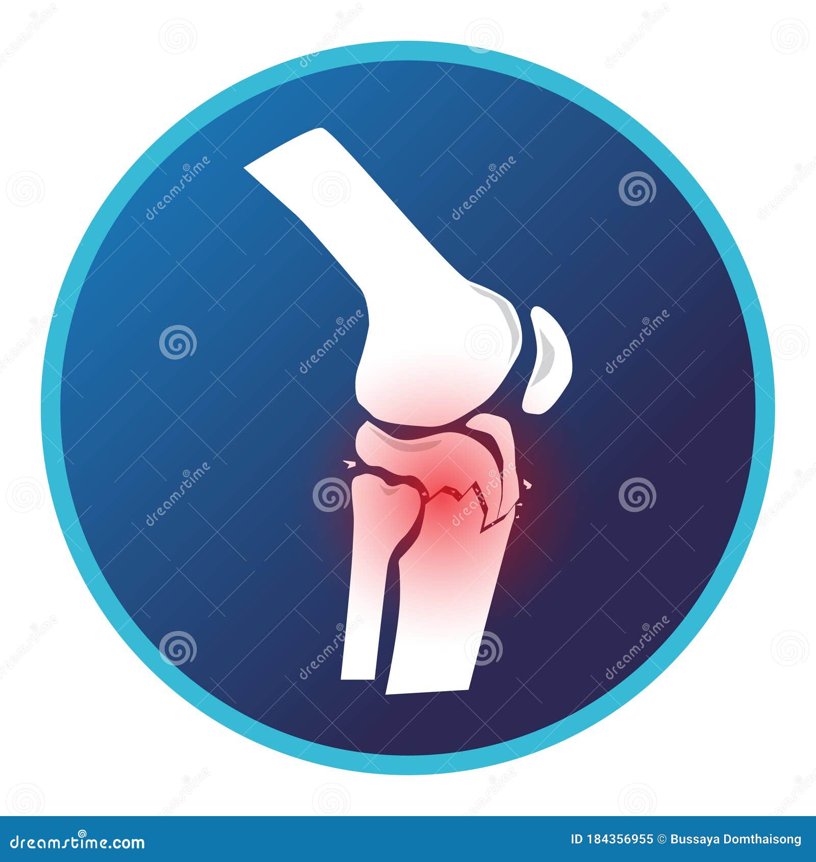 Fracture Tibial Plateau and Knee Icon. Vector Flat Design for Radiology ...