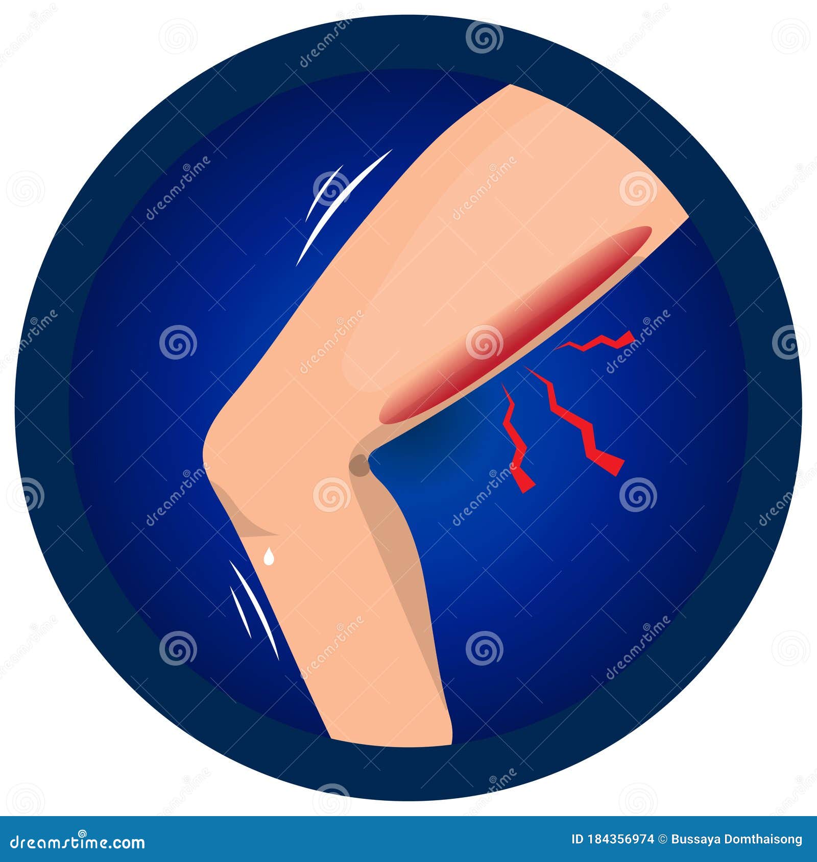 Hamstring Muscle Injury. . Leg Muscle Sport Trauma. Isolated Femur ...