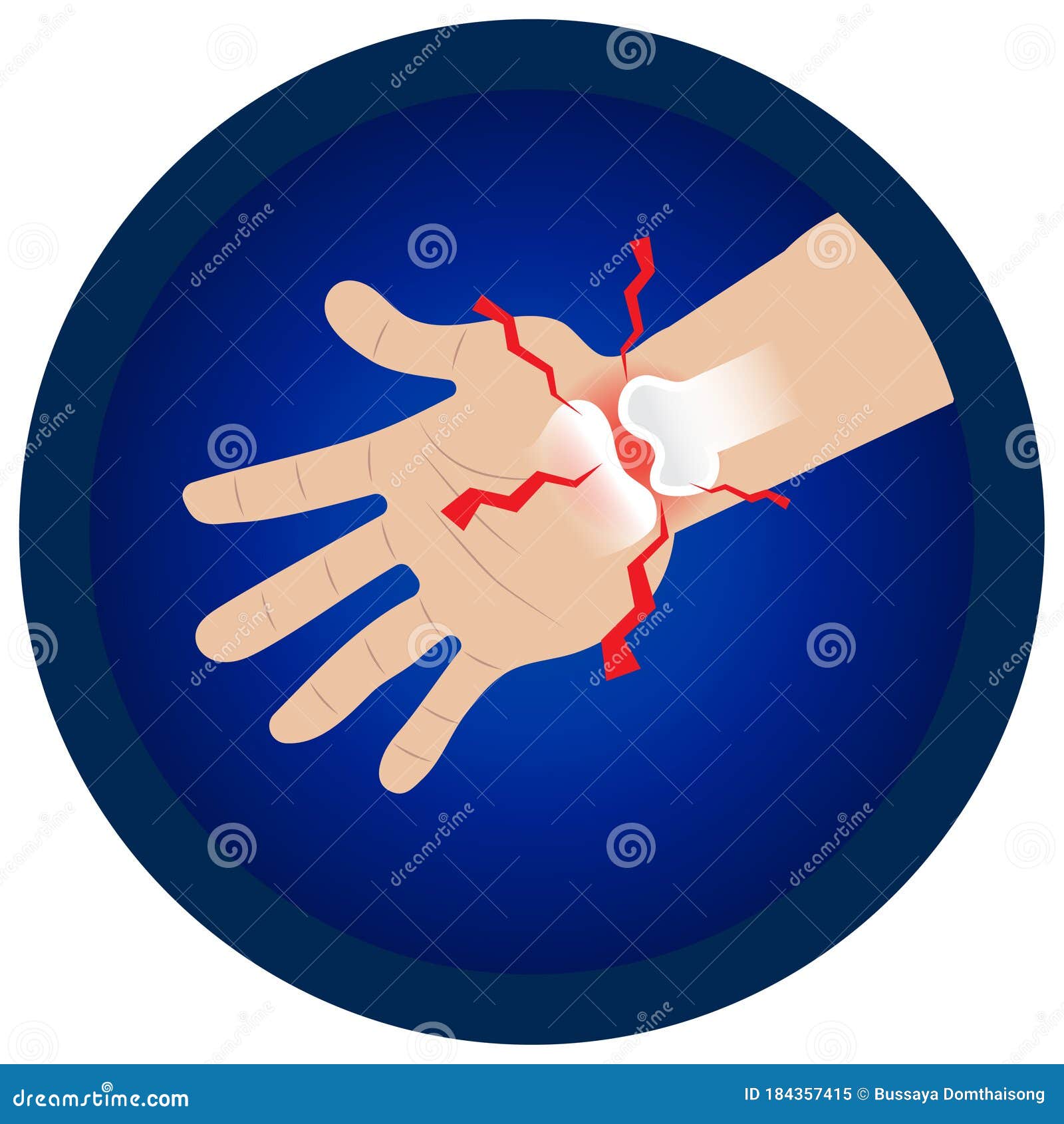 Wrist Fracture Cartoon Vector | CartoonDealer.com #64164101