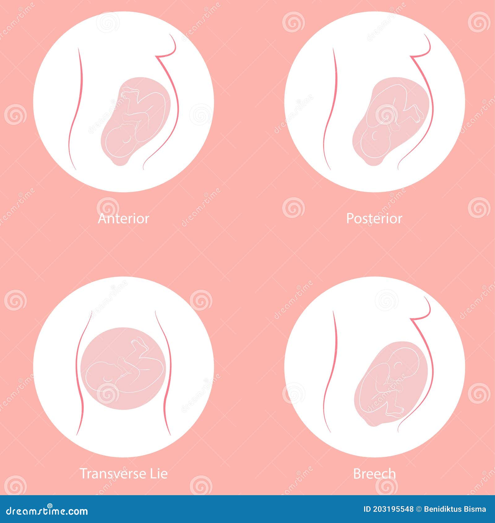 Transverse Baby Presentation. Wrong Baby Positions In Uterus During ...