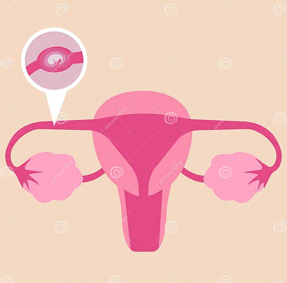 Ectopic Pregnancy or Fallopian Tubes Pregnancy Stock Vector ...