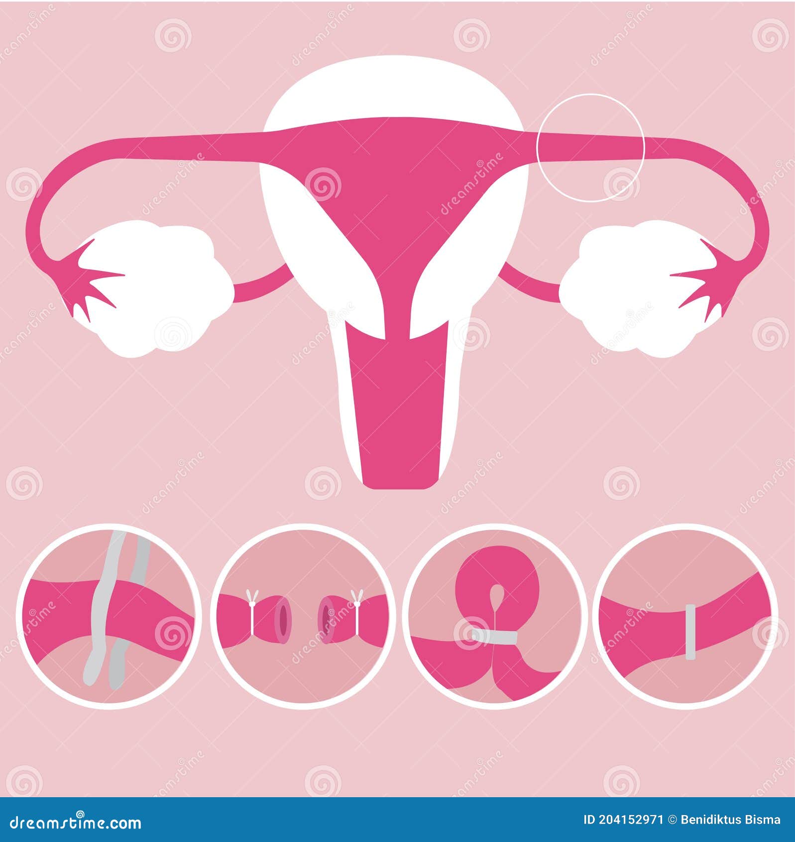 Medical Tubal Ligation for Female Stock Vector - Illustration of ...