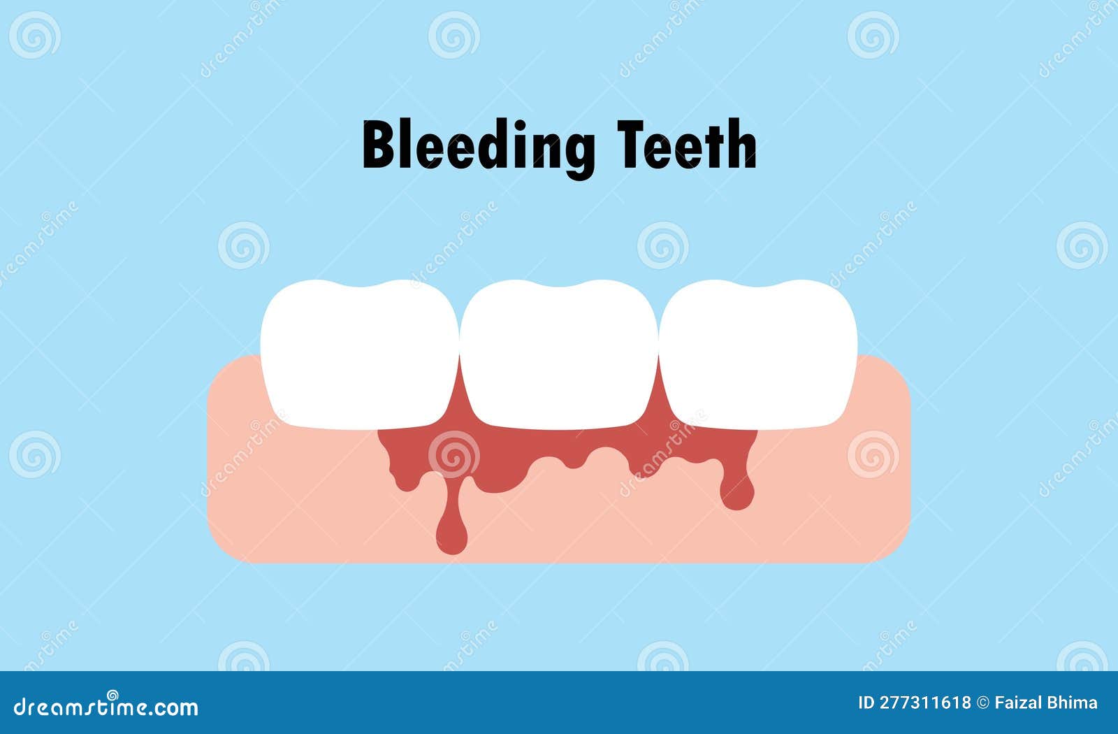 Bleeding White teeth stock vector. Illustration of clinic - 277311618