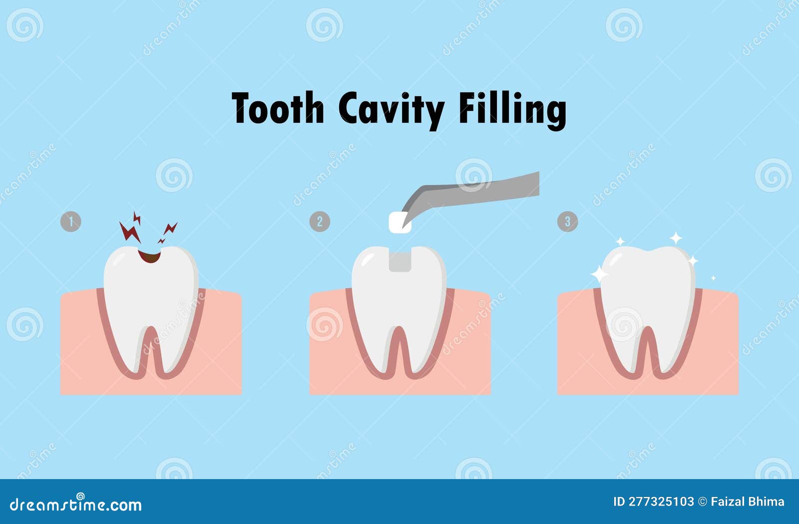 Step of Restoring Tooth Cavity Filling Stock Vector - Illustration of ...